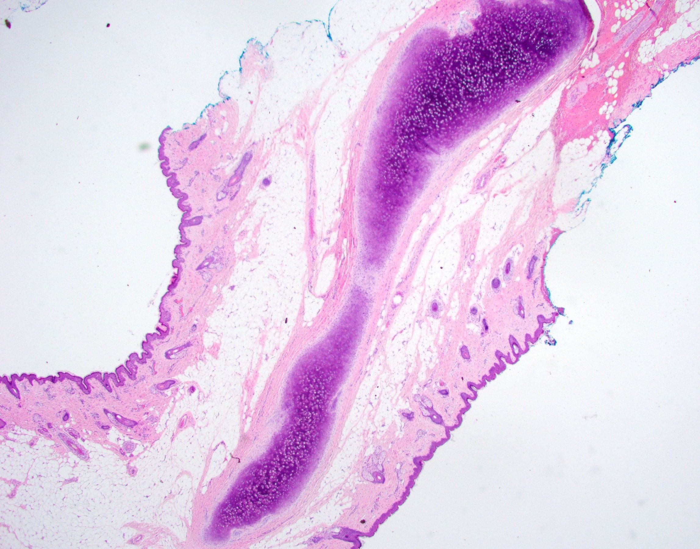 Pathology Outlines - Accessory tragi