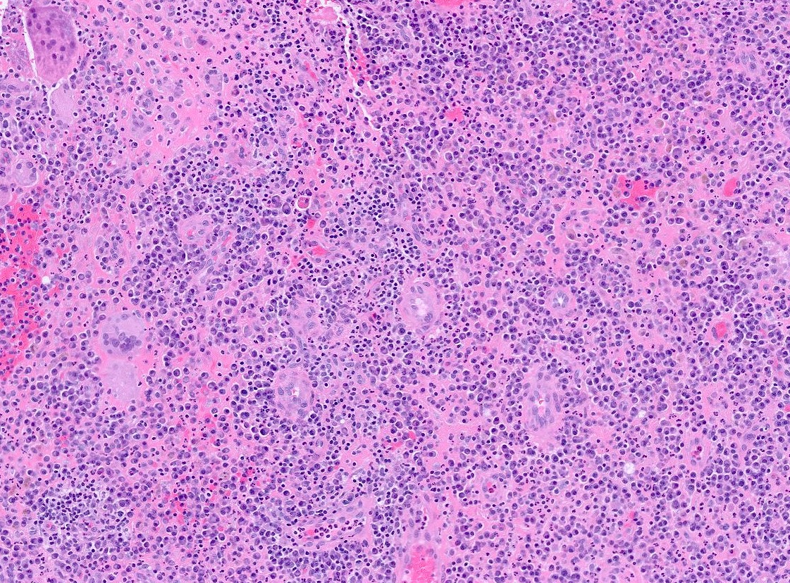 Pathology Outlines - Inflammatory aural / otic polyp