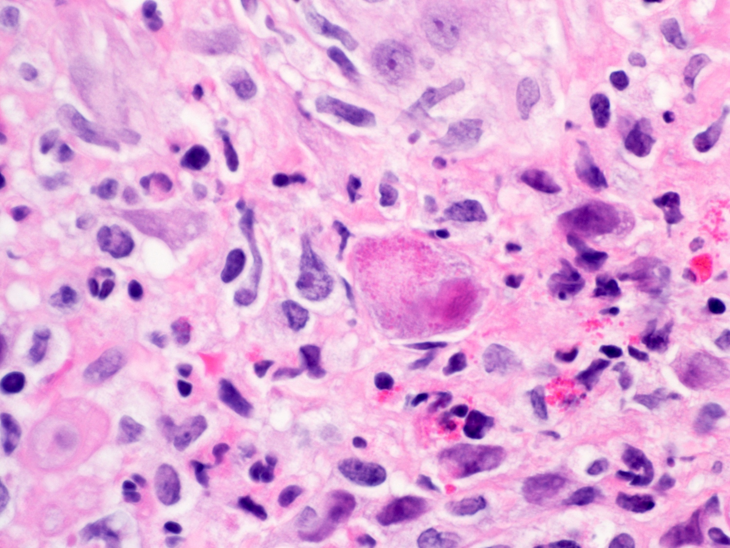 Pathology Outlines - CMV esophagitis