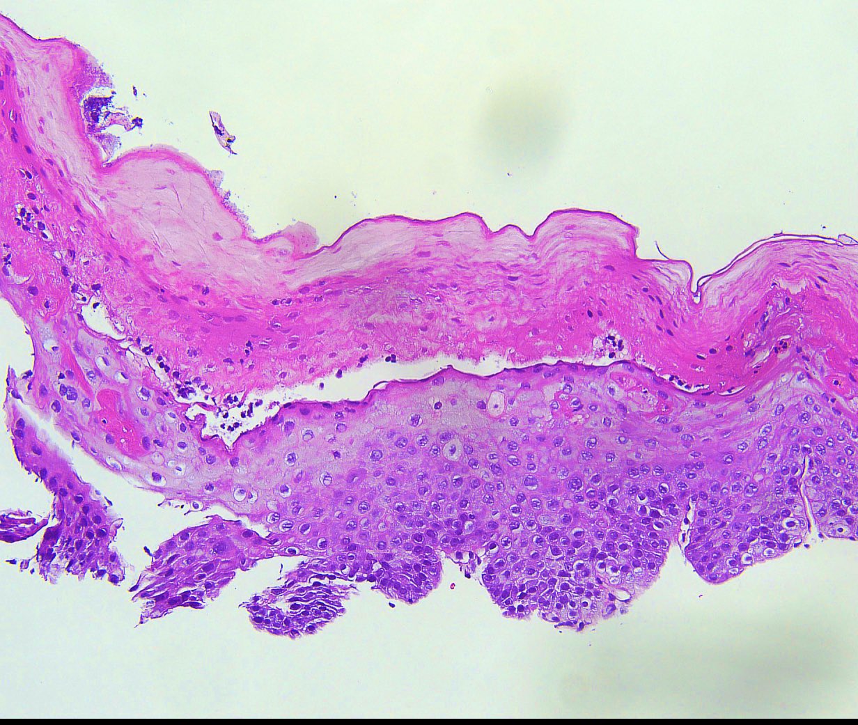 Pathology Outlines Eosinophilic Esophagitis Pathology Of Eosinophilic
