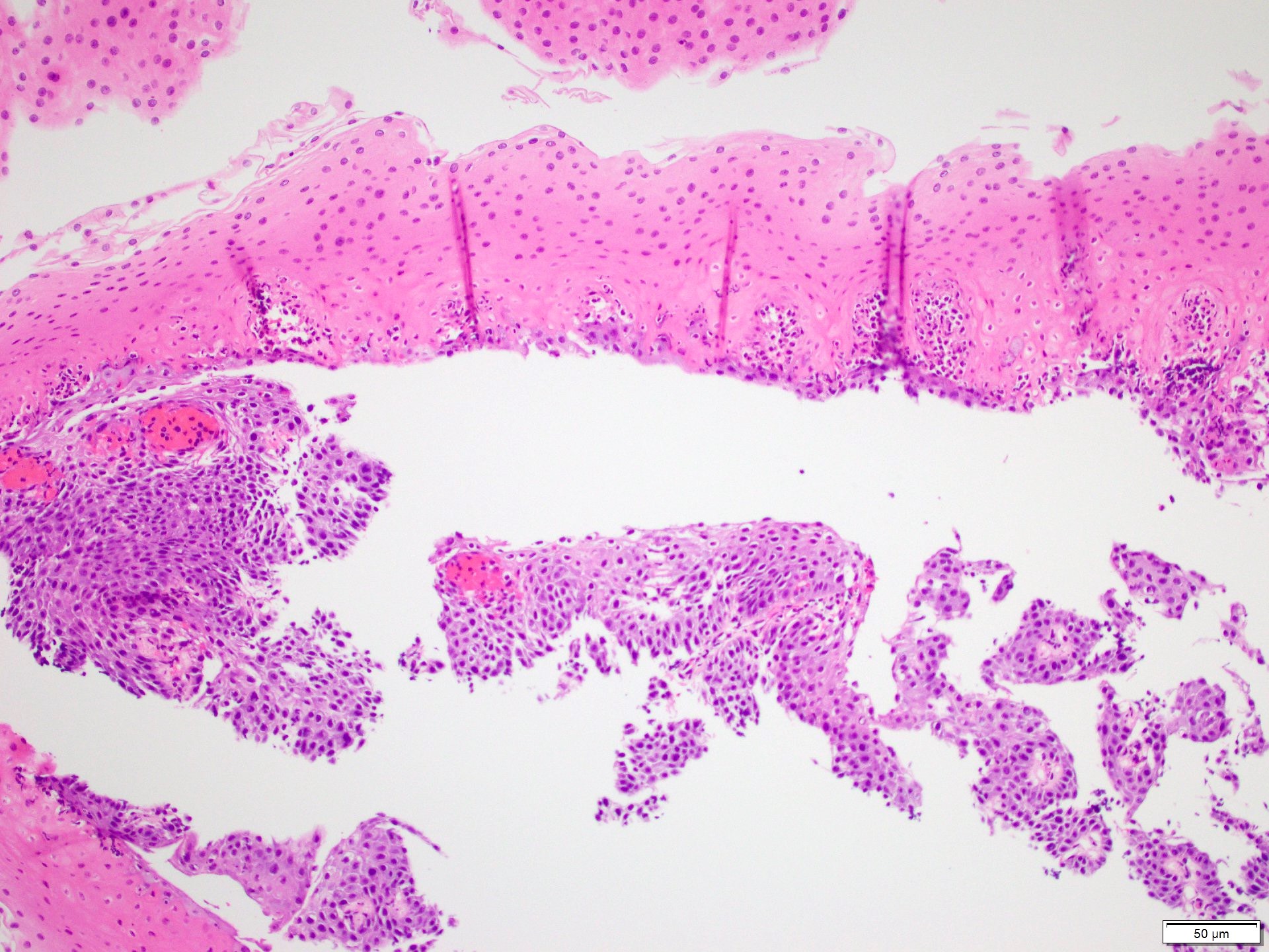 Pathology Outlines Eosinophilic Esophagitis Pathology Of Eosinophilic