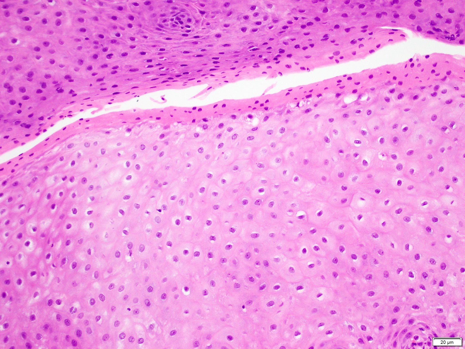 Pathology Outlines - Esophagitis dissecans superficialis / sloughing ...