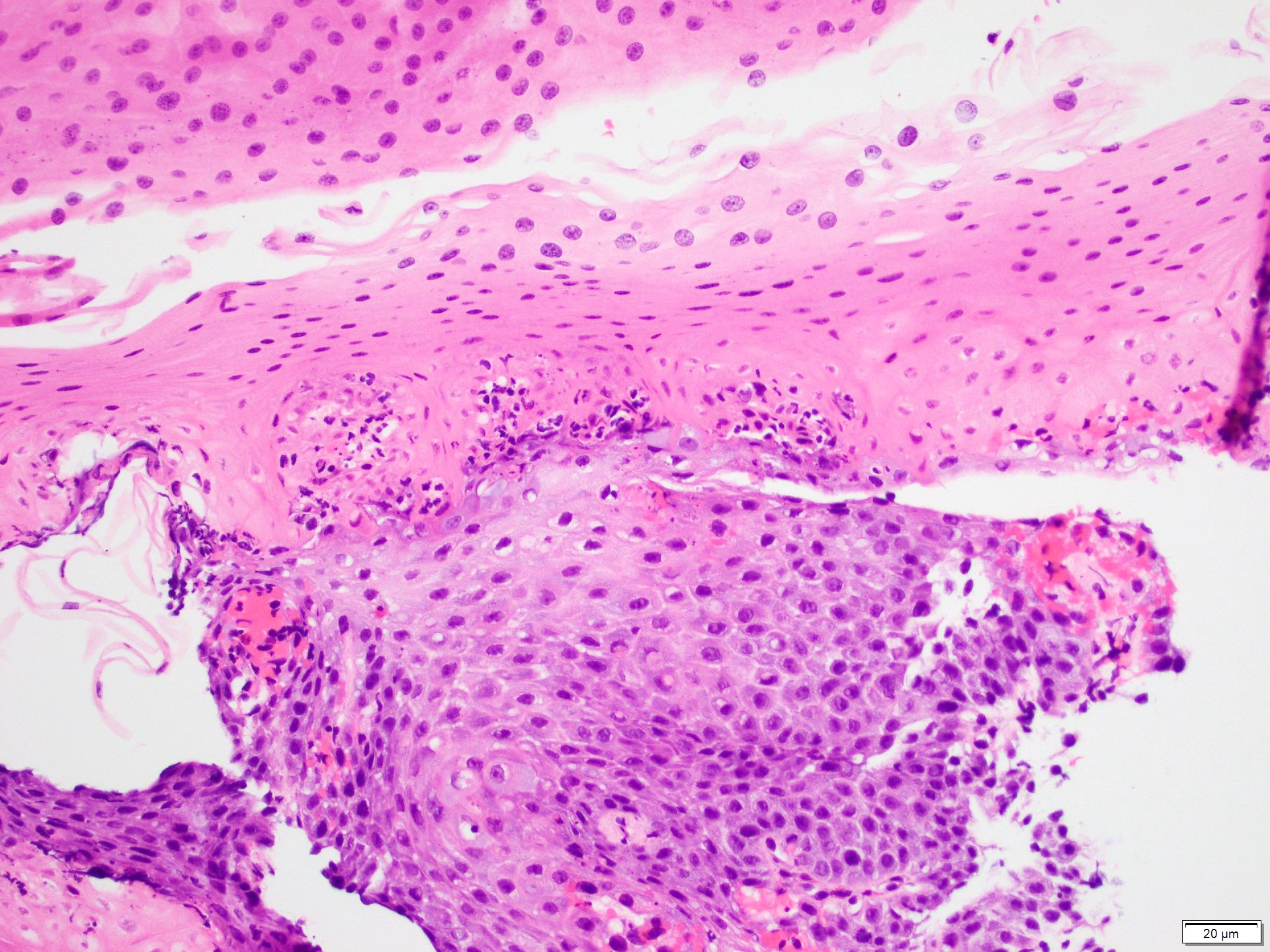 Pathology Outlines Eosinophilic Esophagitis Pathology Of Eosinophilic