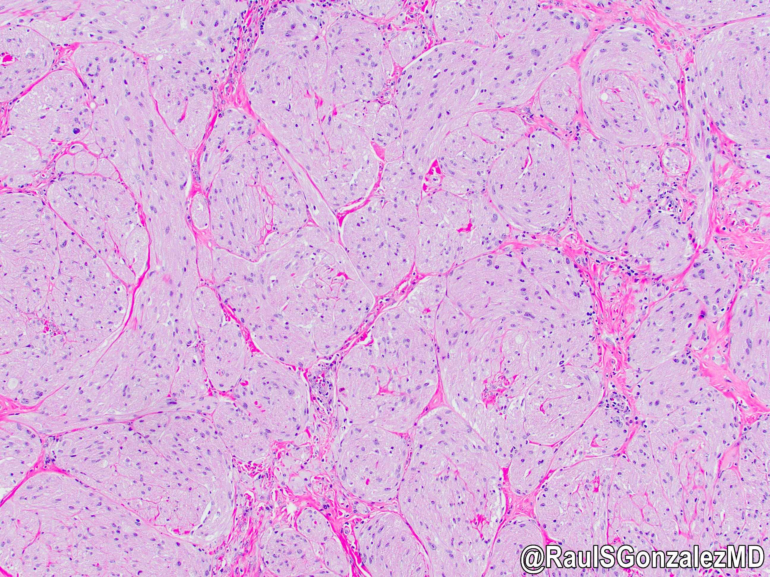 Pathology Outlines - Granular cell tumor