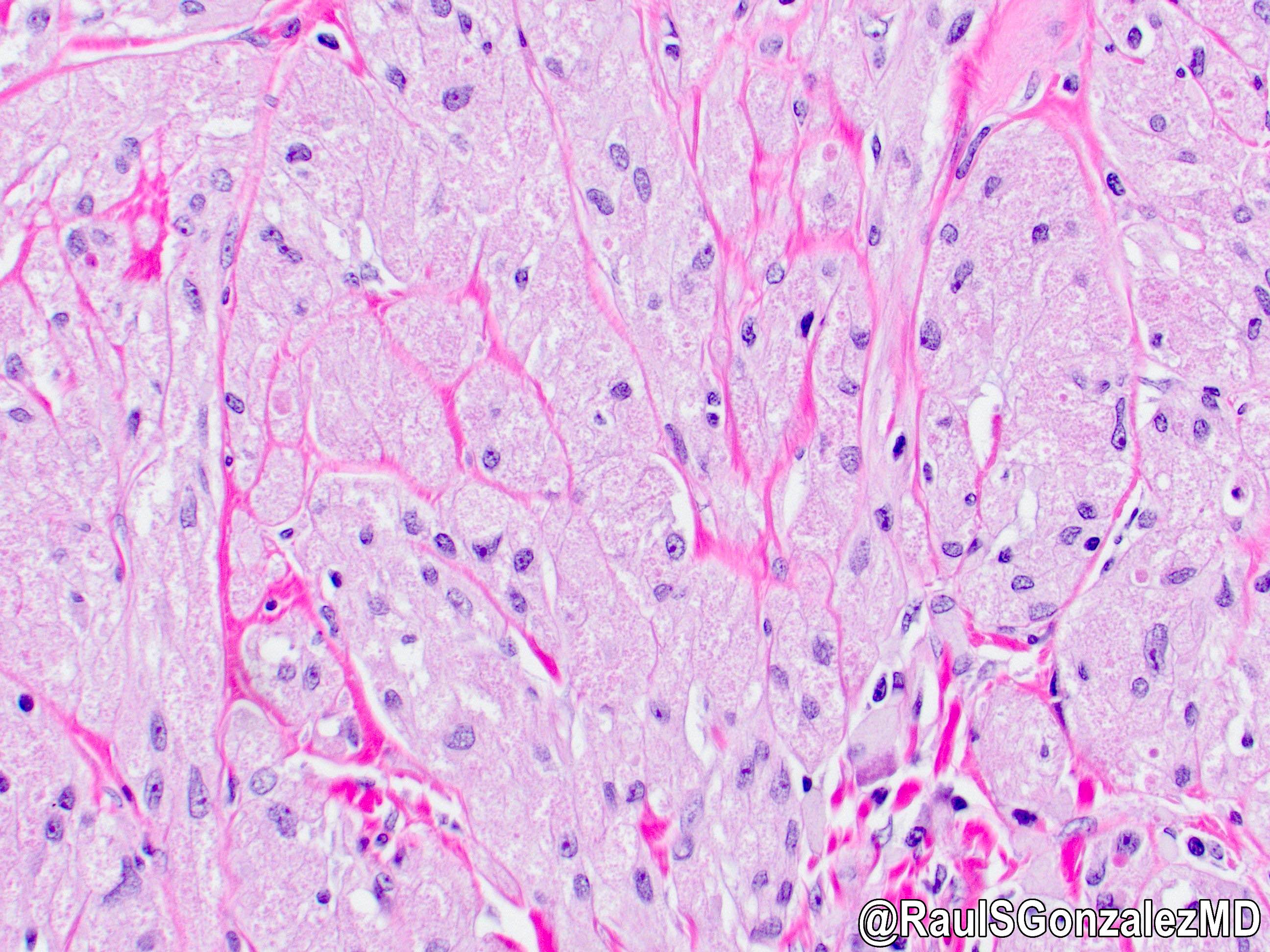Pathology Outlines - Granular cell tumor