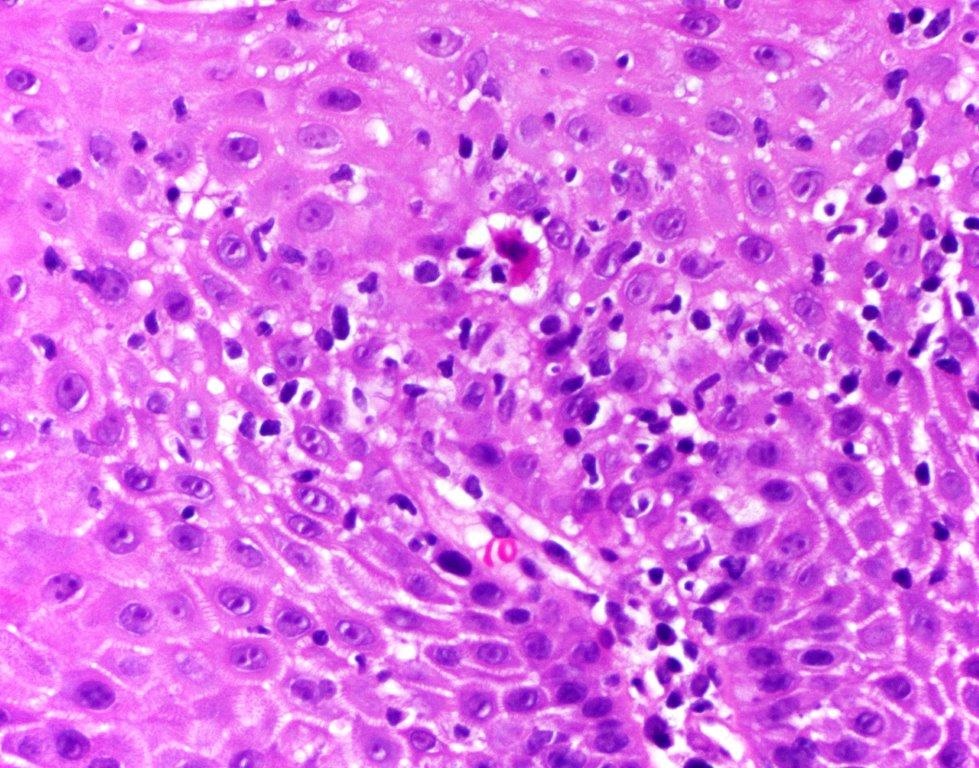Pathology Outlines Eosinophils Pathology Outlines Eosinophils