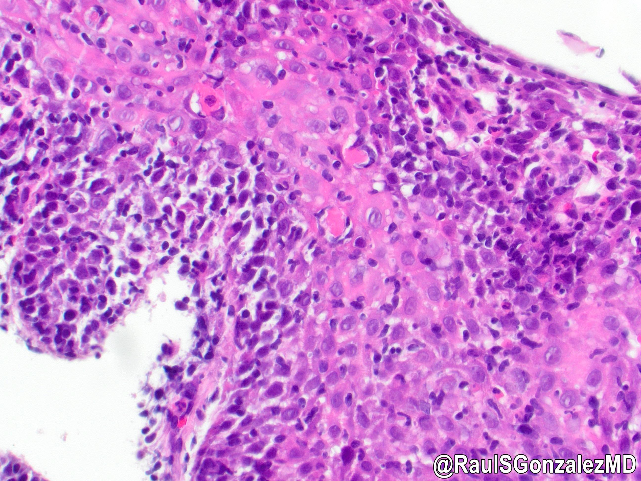 Pathology Outlines Eosinophils Pathology Outlines Eosinophils