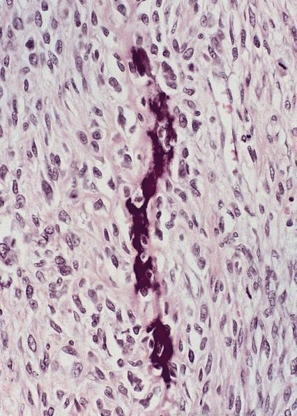 Pathology Outlines - Sarcomatoid carcinoma