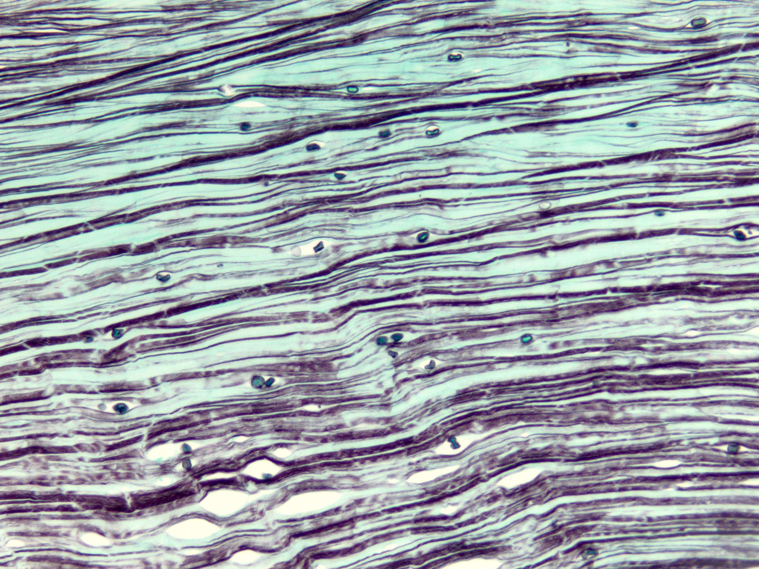 Pathology Outlines - Acanthamoeba keratitis