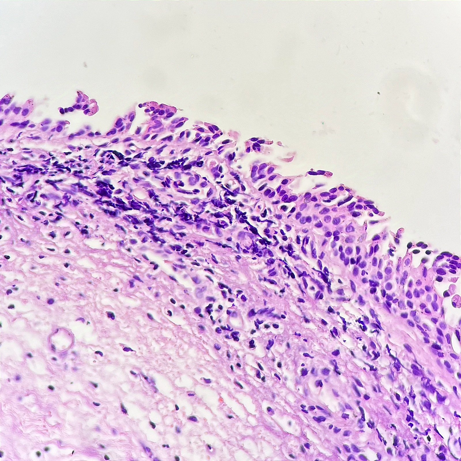 Pathology Outlines - Dacryocystitis