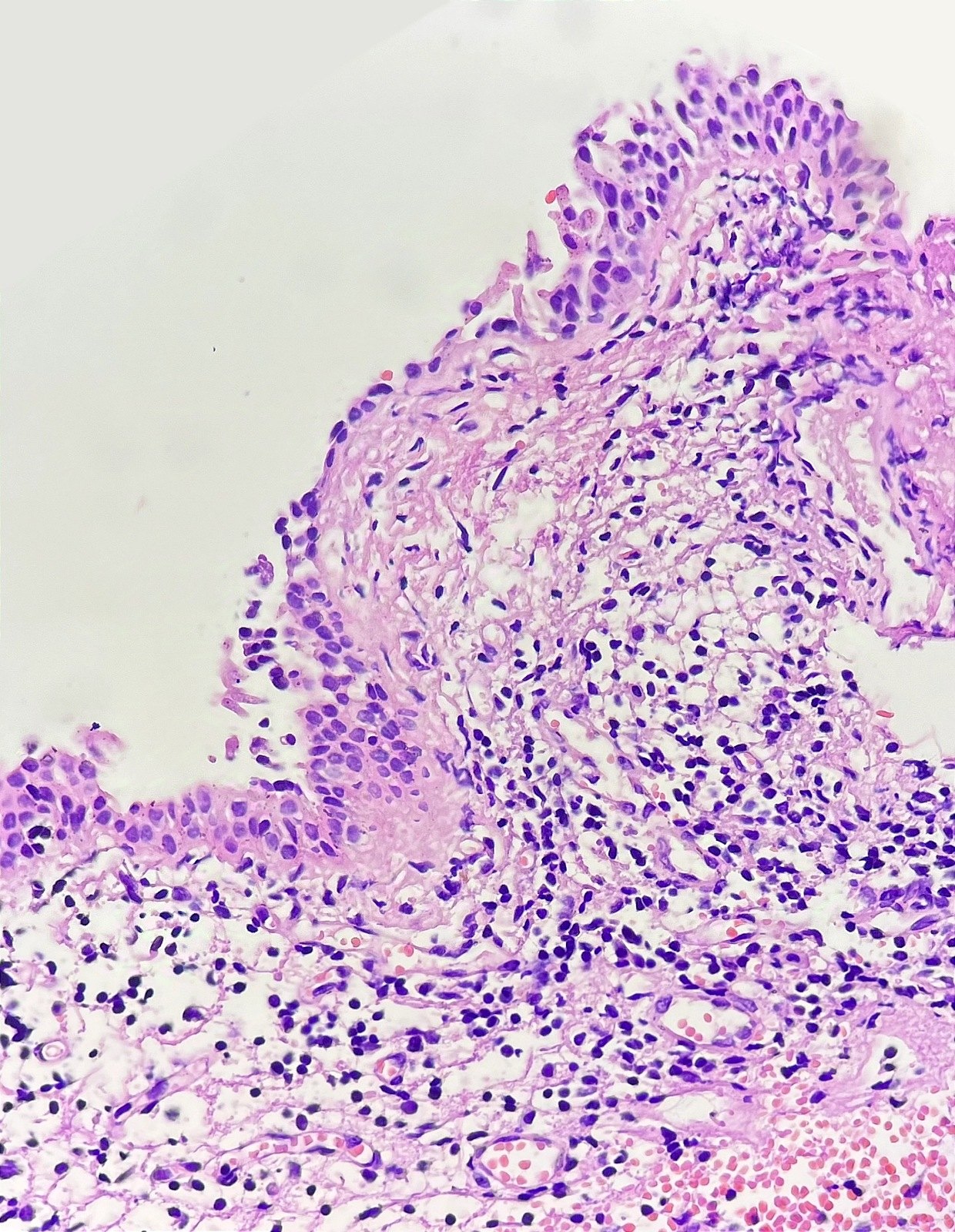 Pathology Outlines - Dacryocystitis