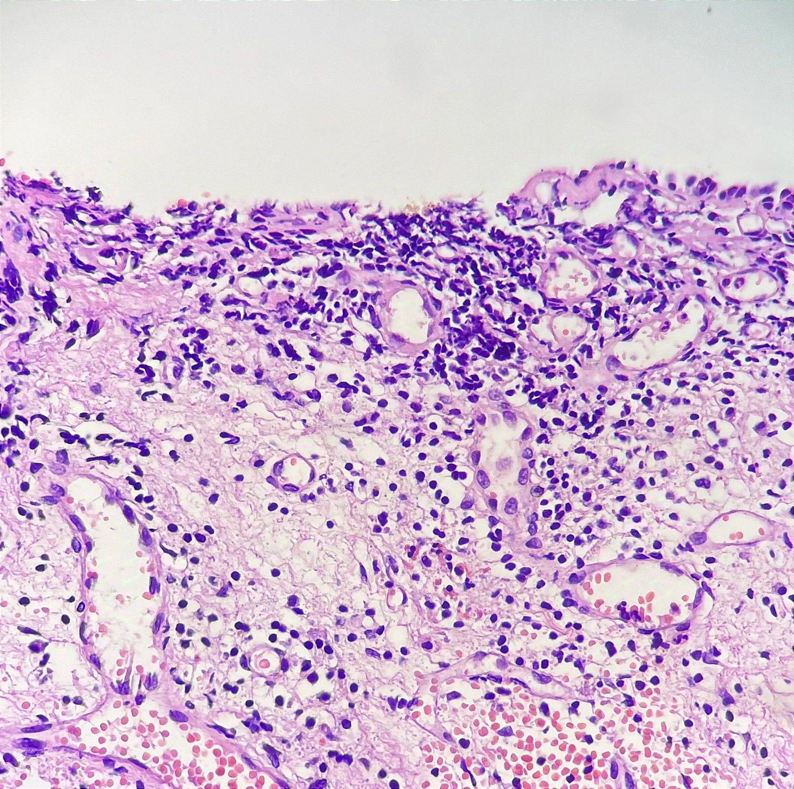 Pathology Outlines - Dacryocystitis