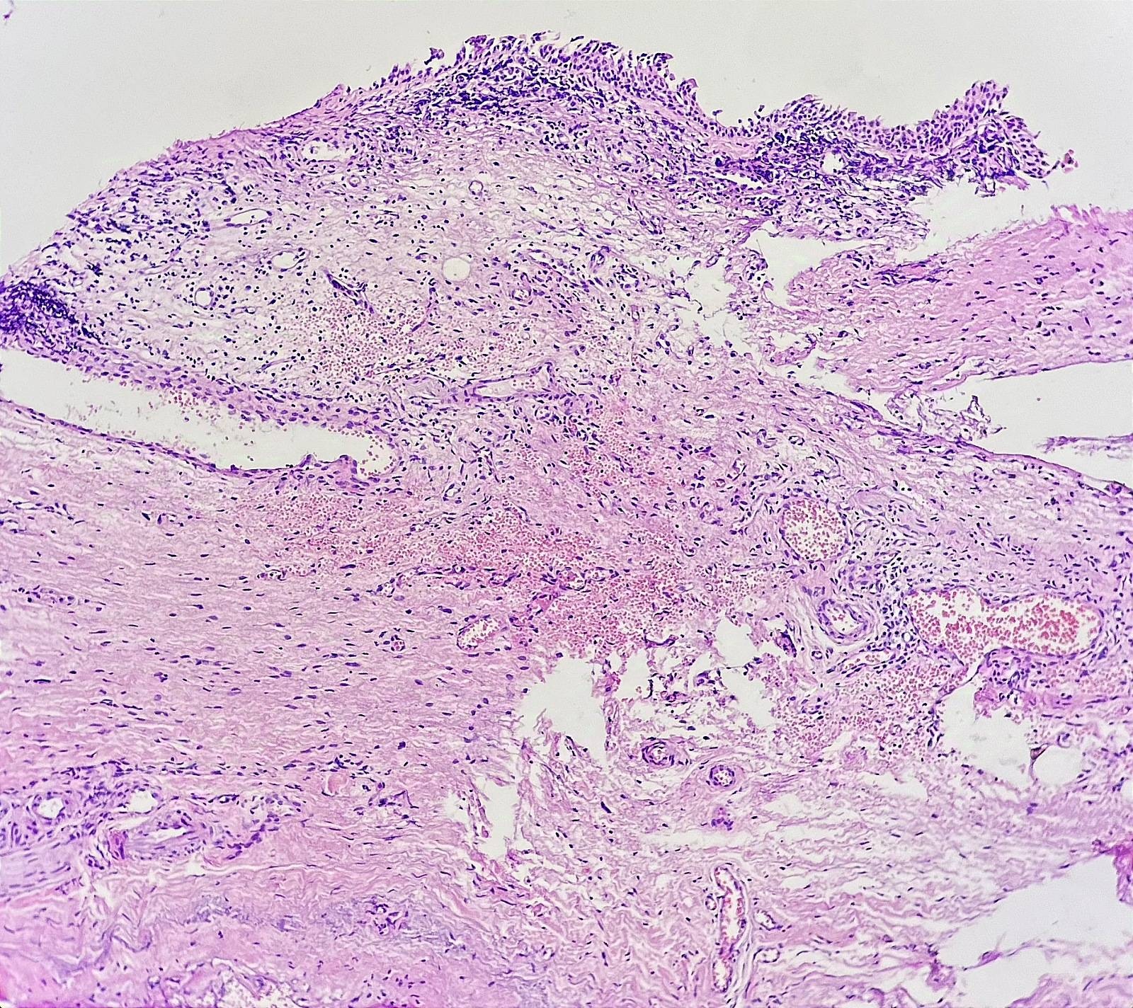 Pathology Outlines - Dacryocystitis