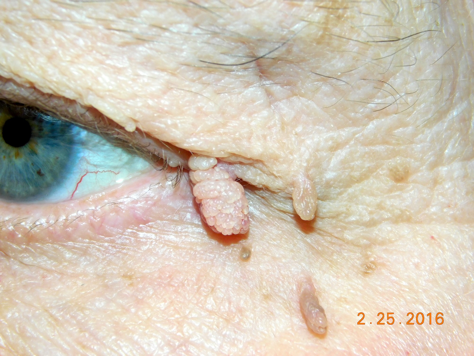 Pathology Outlines - Squamous papilloma-eyelid