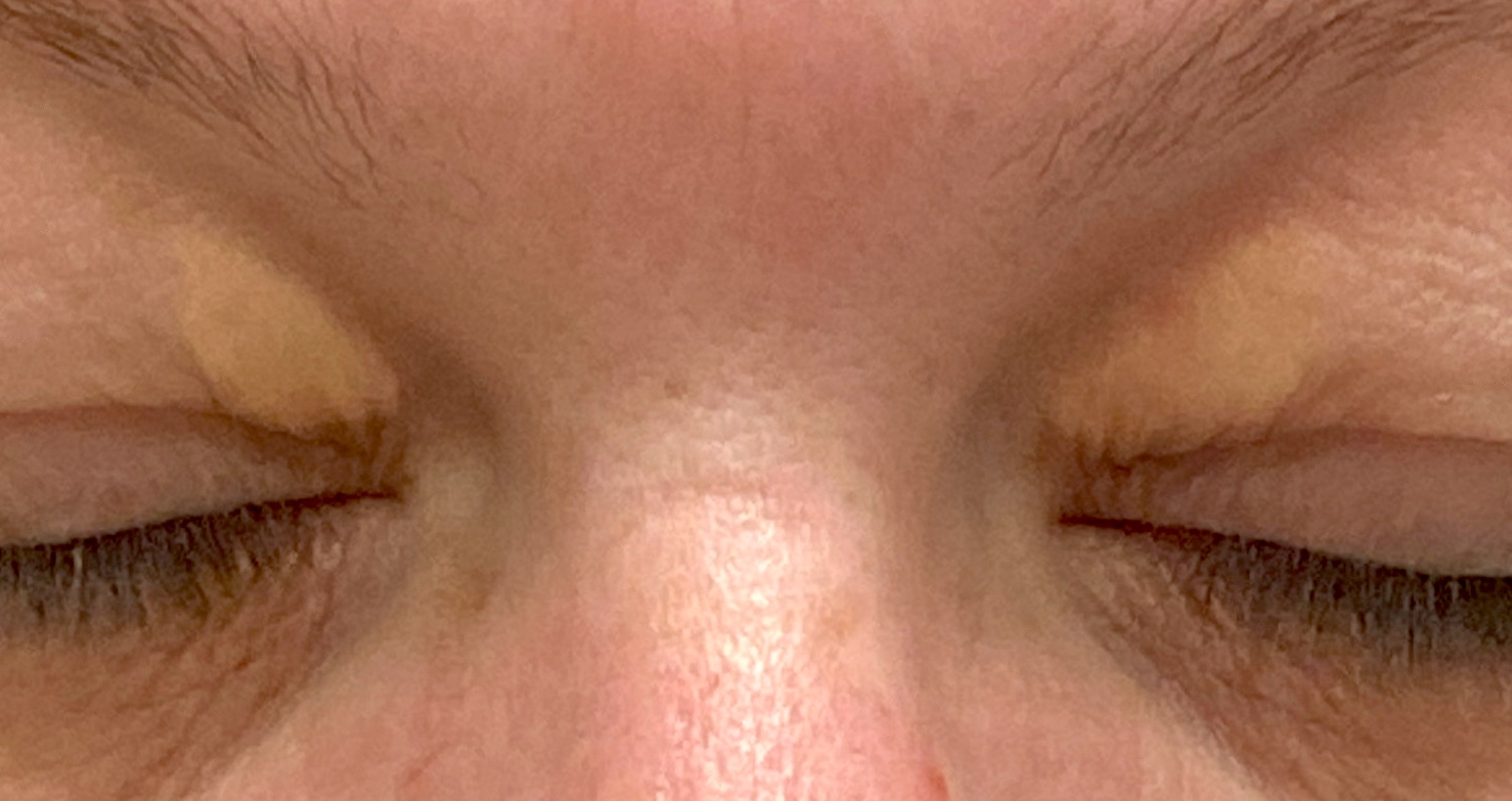 Xanthelasma Palpebrarum Increases Markers Indicative Of