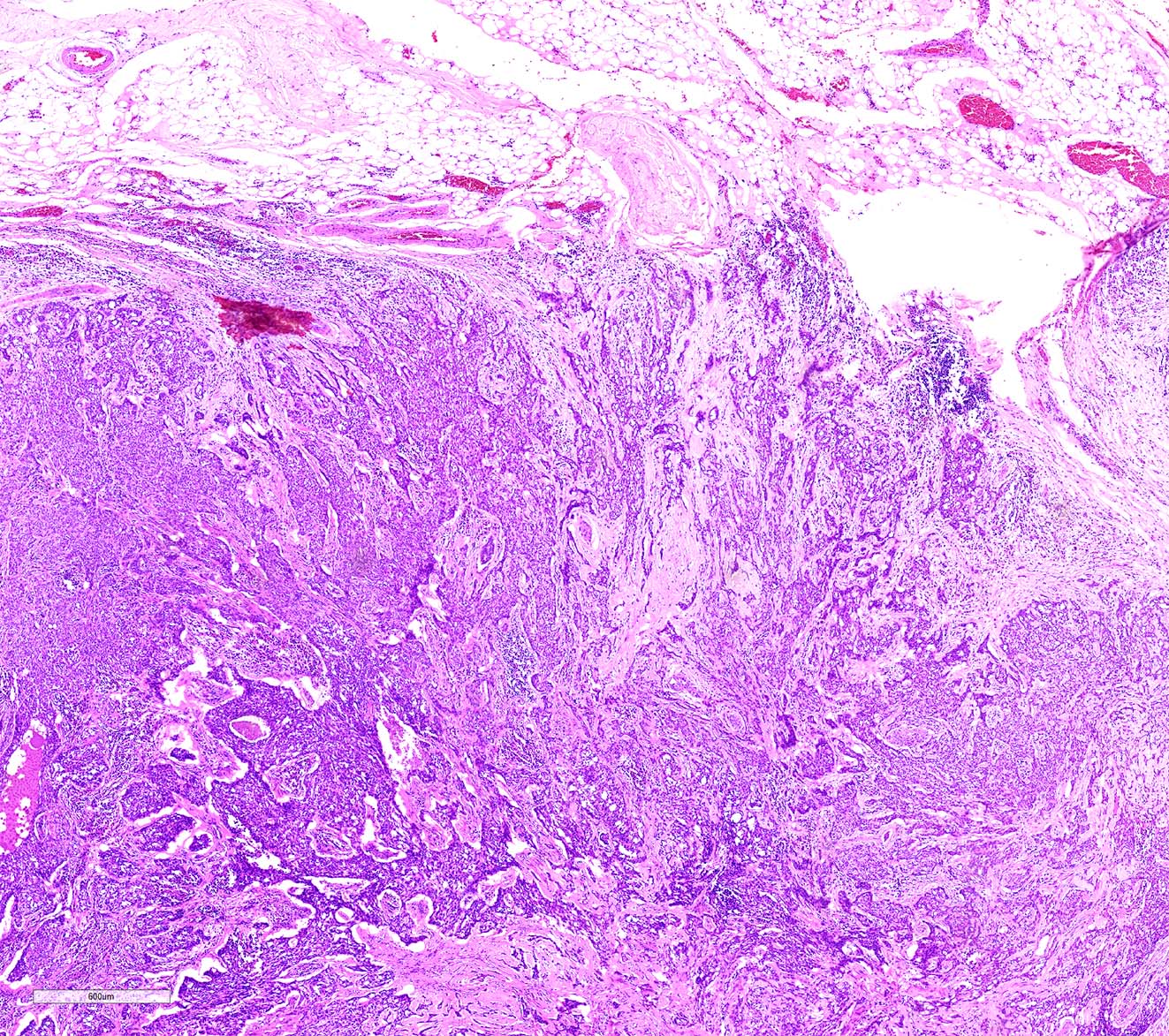 Pathology Outlines - Staging-eyelid