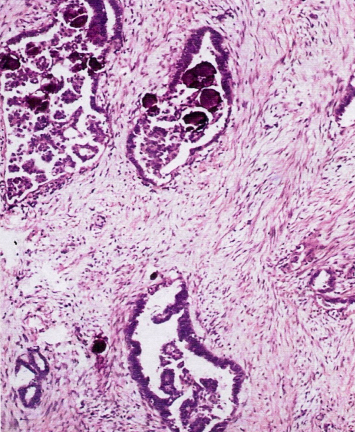 Pathology Outlines - High grade serous carcinoma