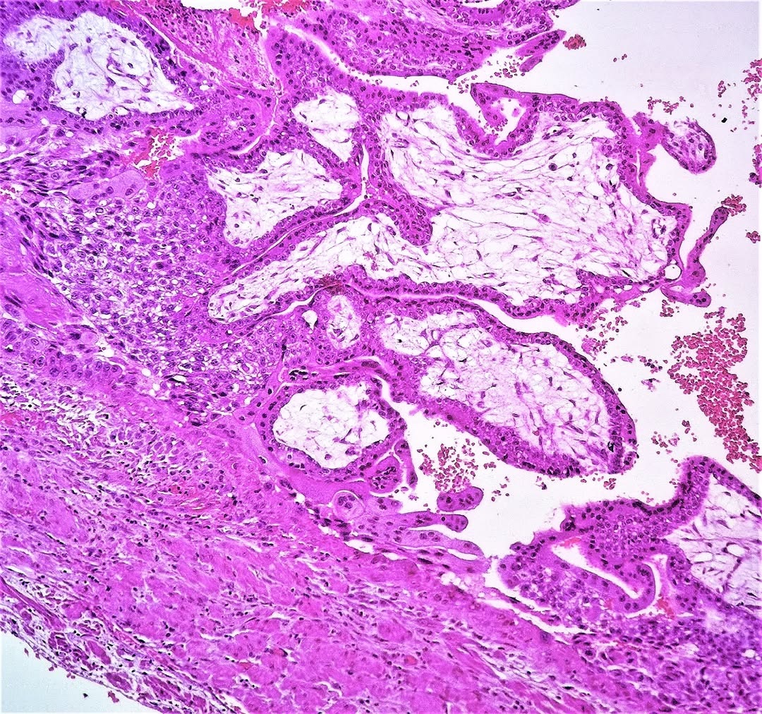 Pathology Outlines - Ectopic / tubal pregnancy