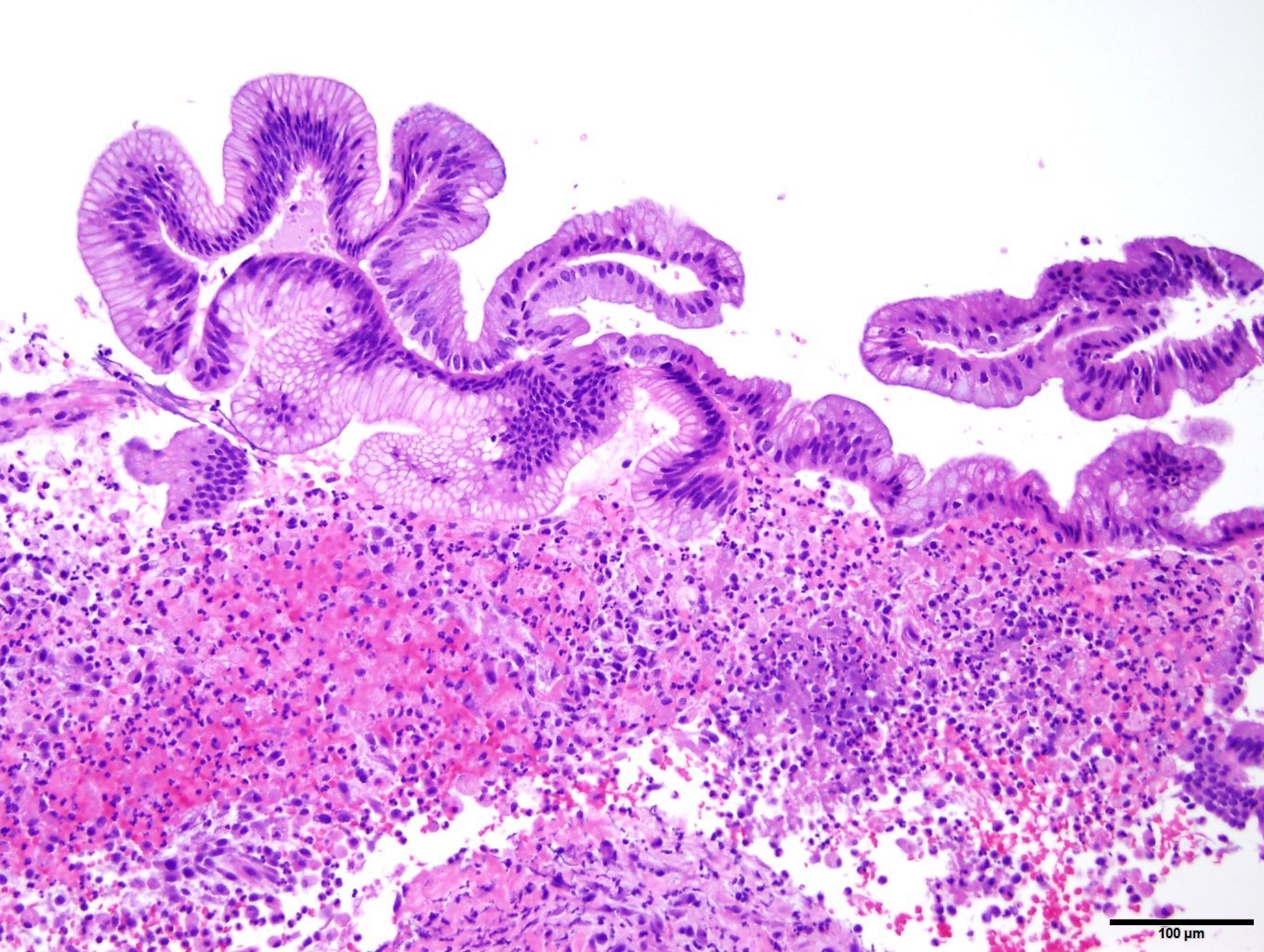 Pathology Outlines - Metaplasia