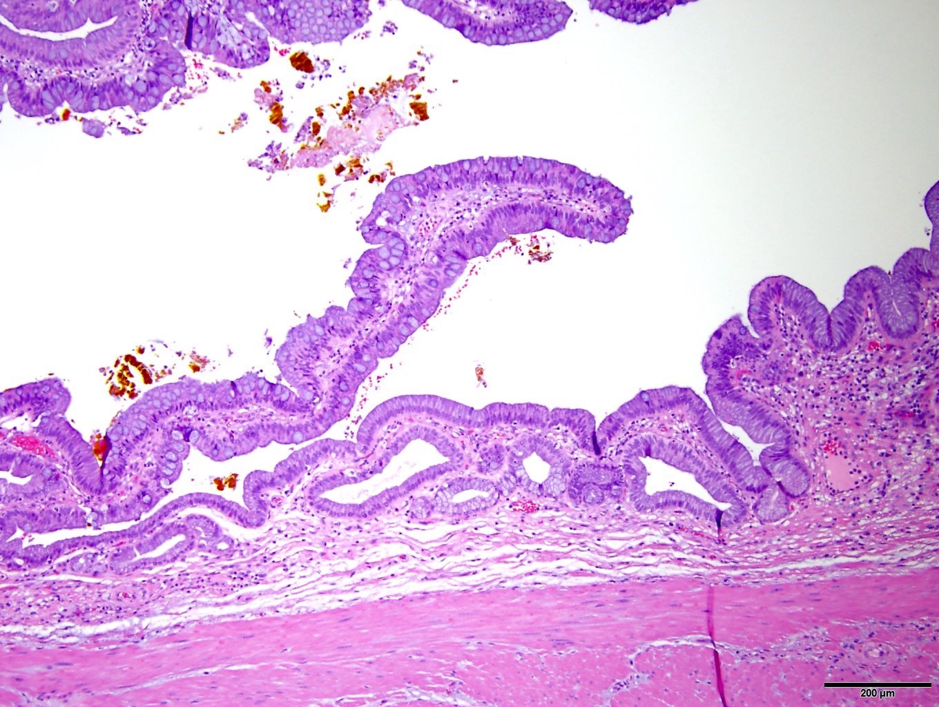 Pathology Outlines - Metaplasia