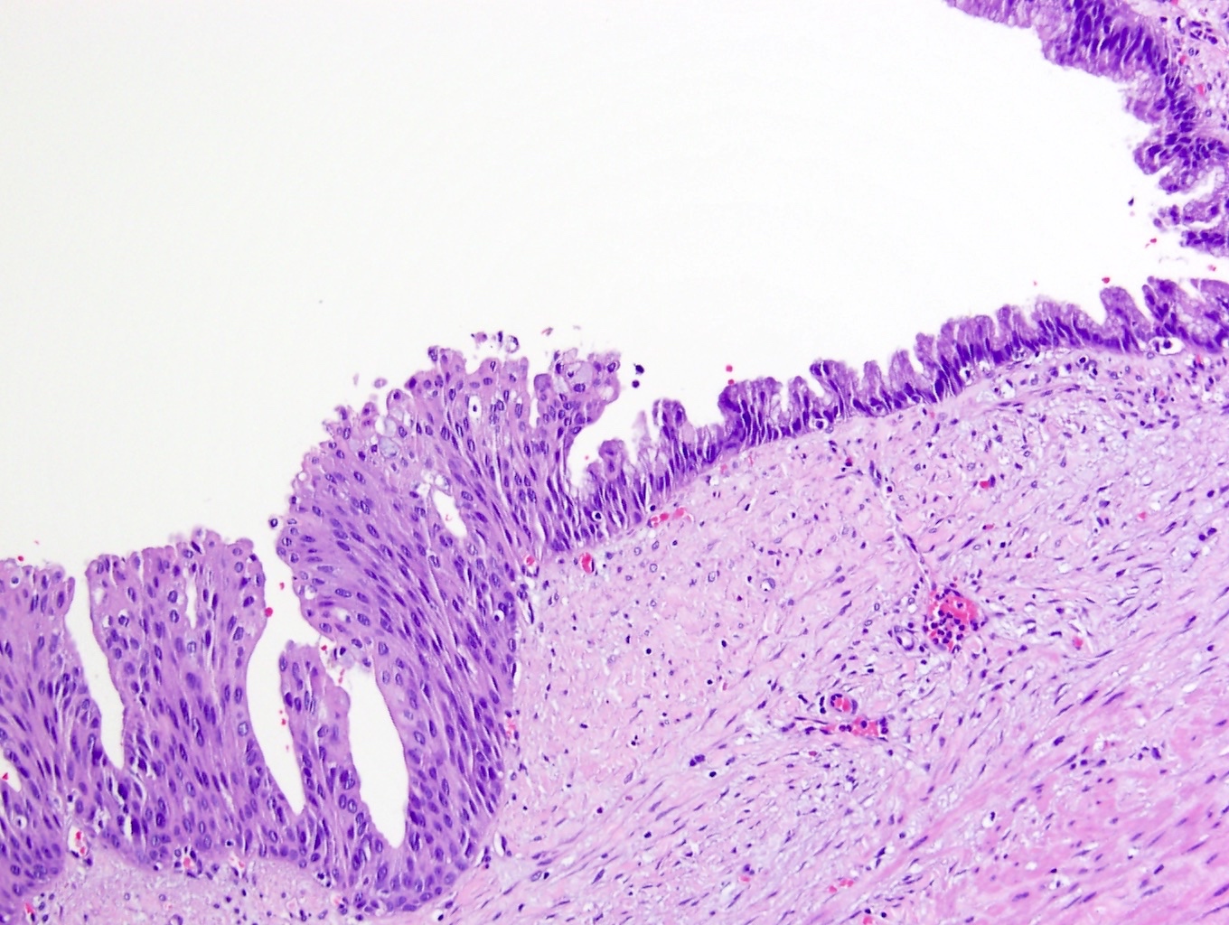 Pathology Outlines - Metaplasia