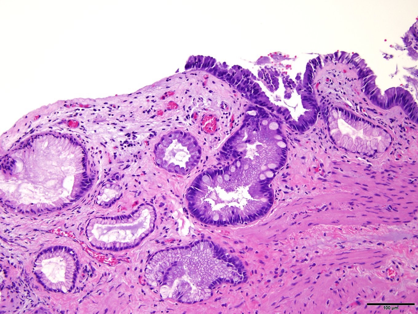 Pathology Outlines - Metaplasia
