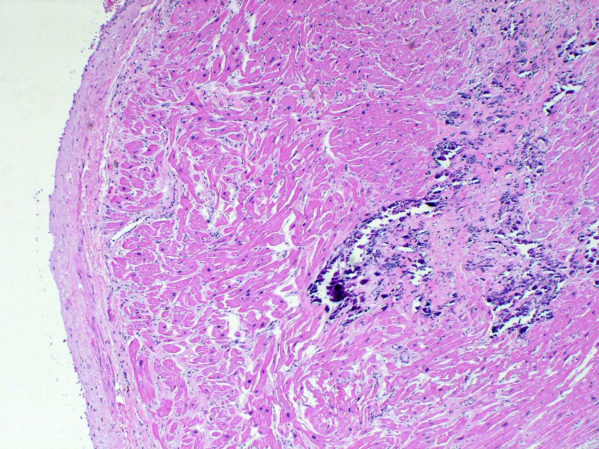 Tonsillar Hypertrophy Pathology Outlines