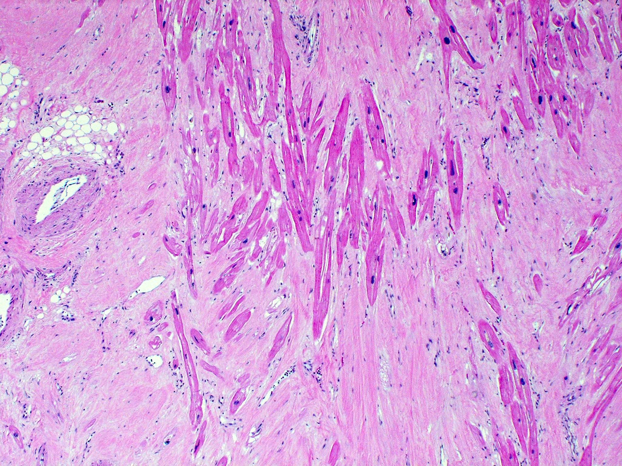 Pathology Outlines - Hypertrophic cardiomyopathy