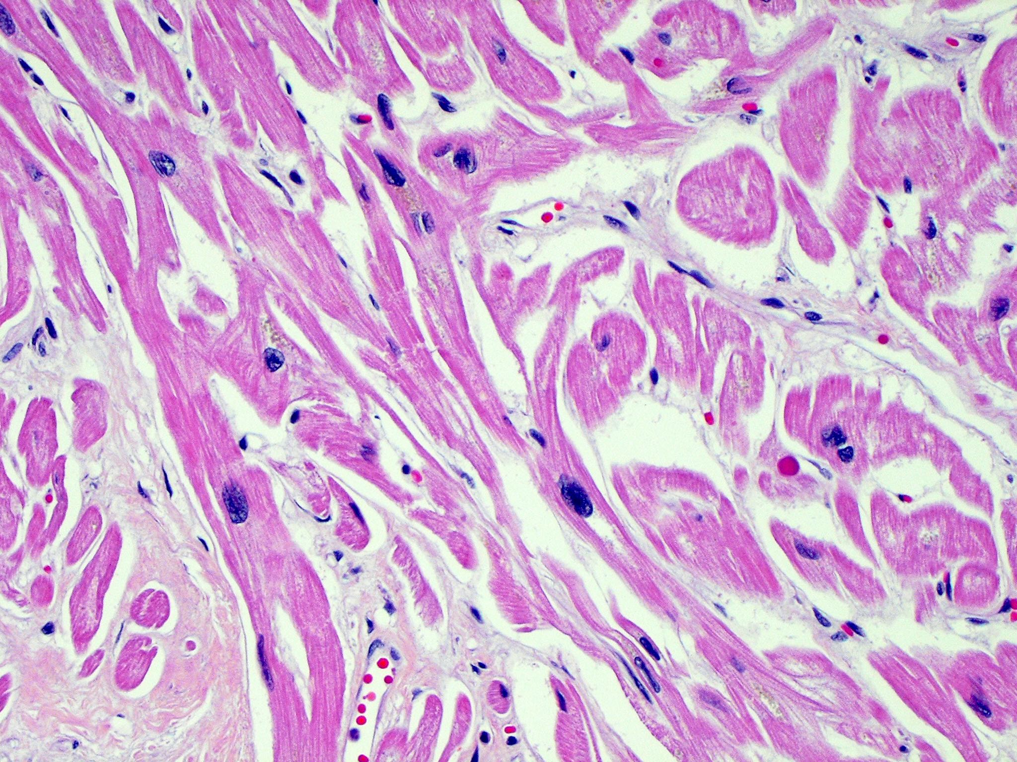 Pathology Outlines - Hypertrophic cardiomyopathy