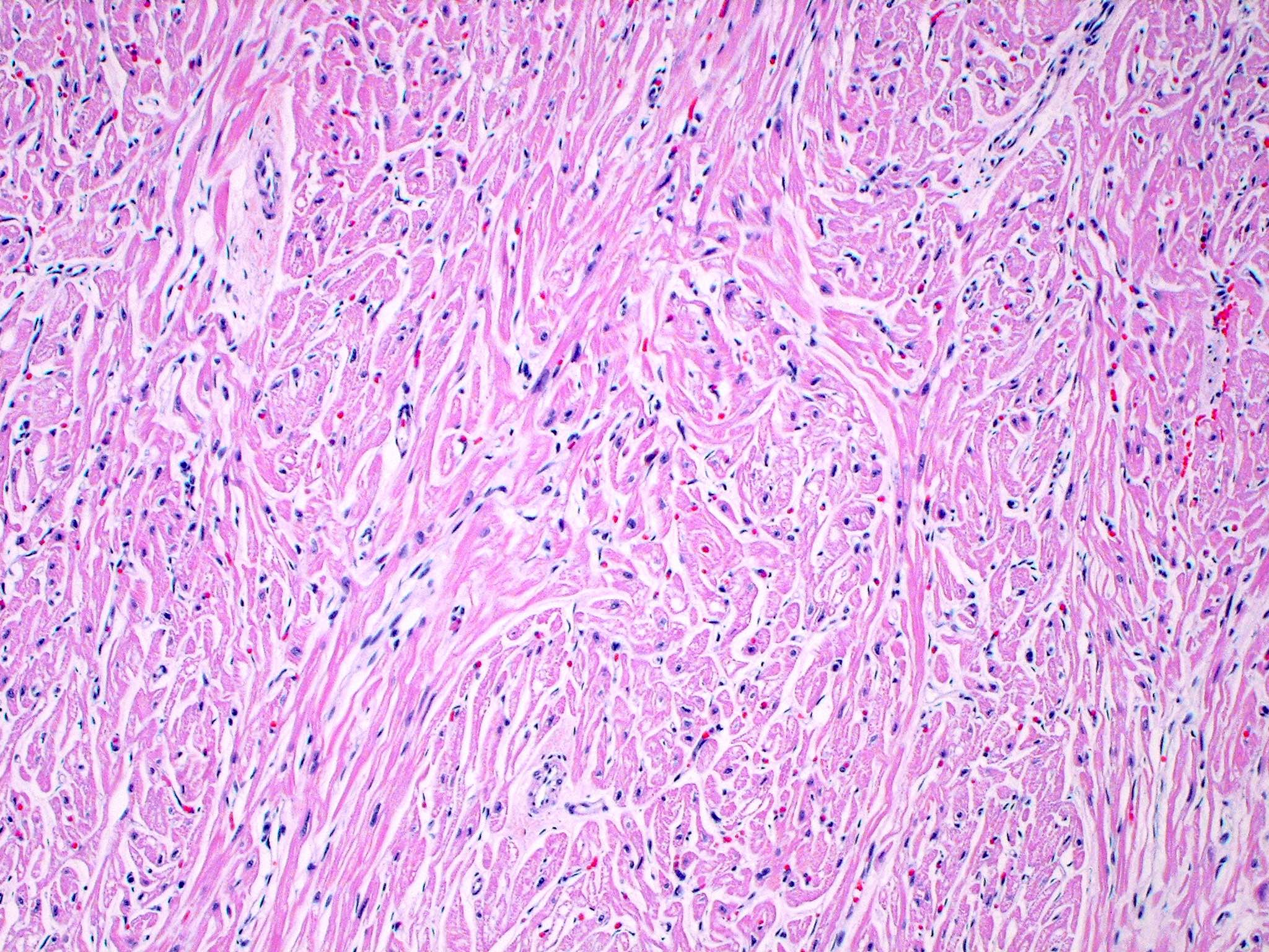 Pathology Outlines - Hypertrophic cardiomyopathy