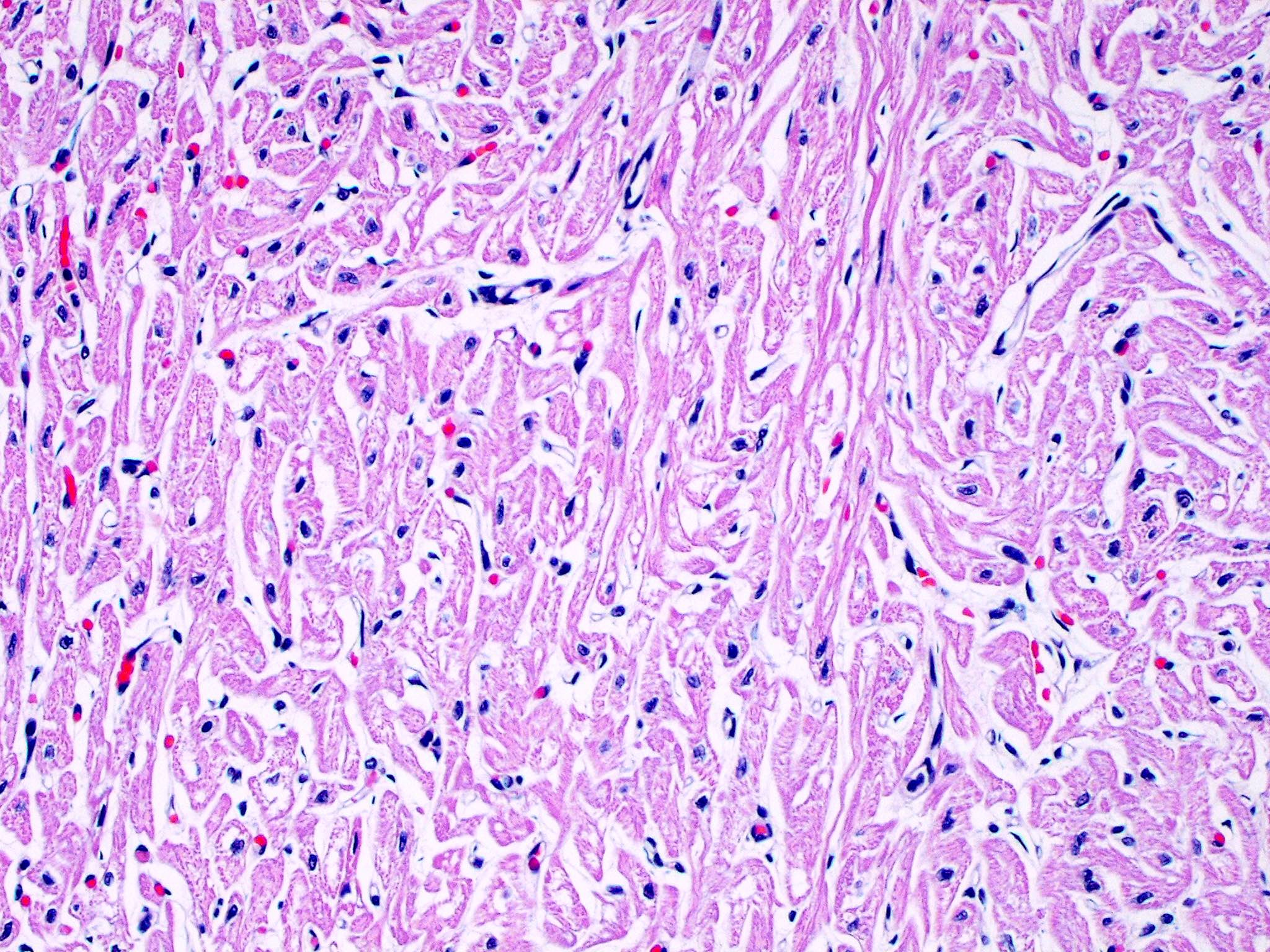 Pathology Outlines - Hypertrophic cardiomyopathy