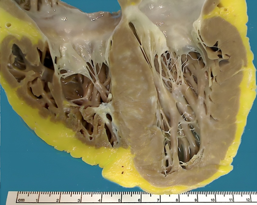 Pathology Outlines - Hypertrophic cardiomyopathy
