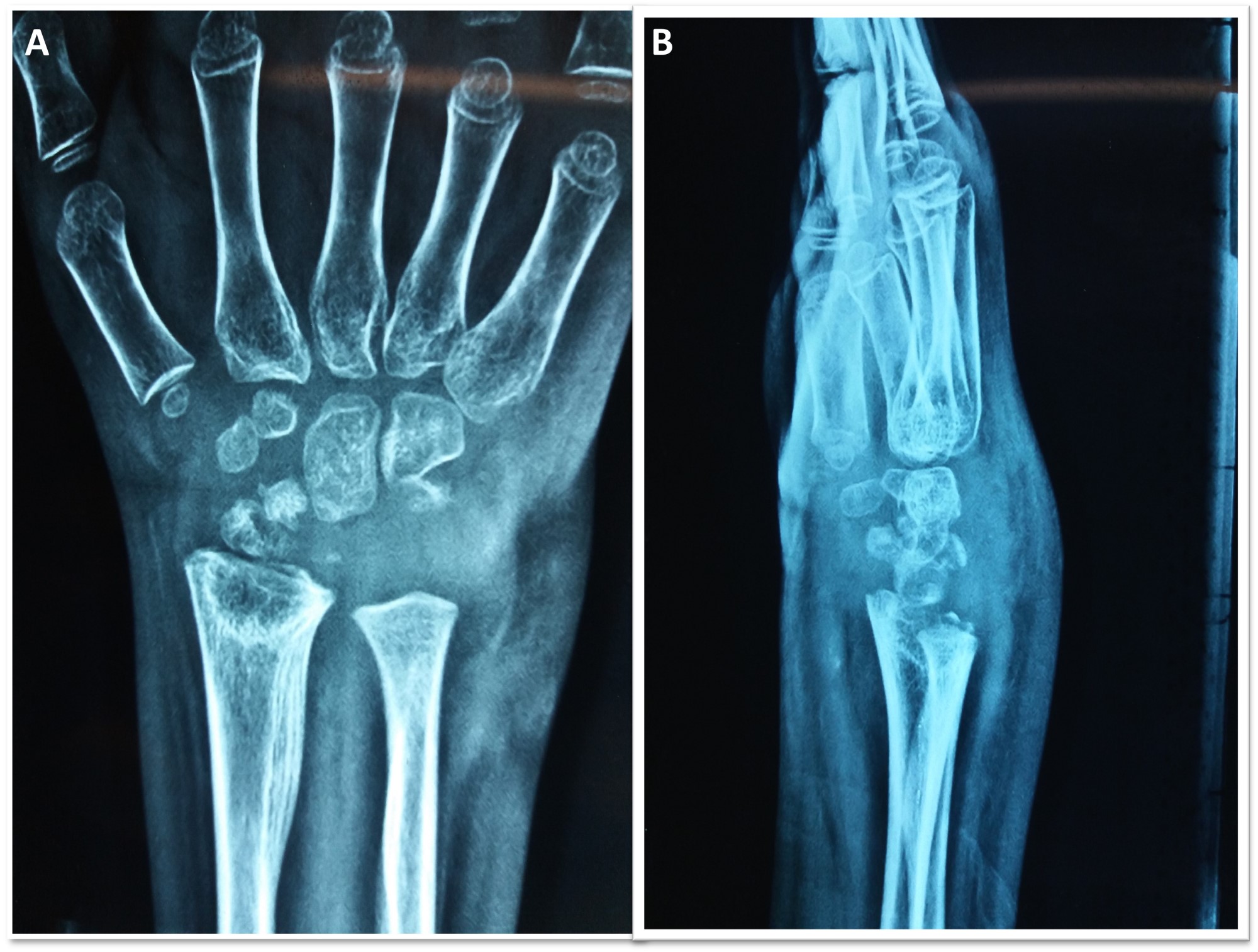 Pathology Outlines - Tuberculous arthritis