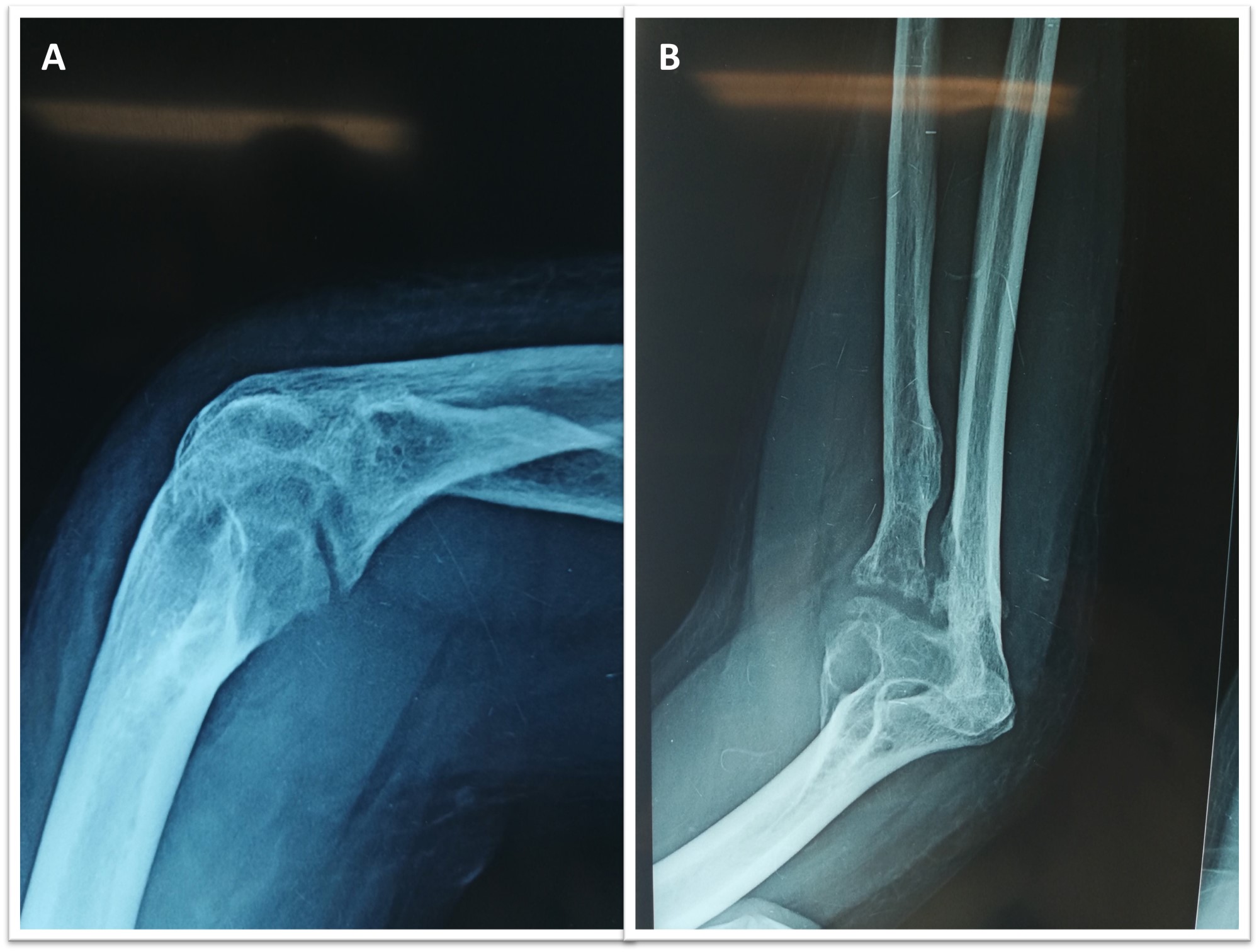 Pathology Outlines - Tuberculous arthritis