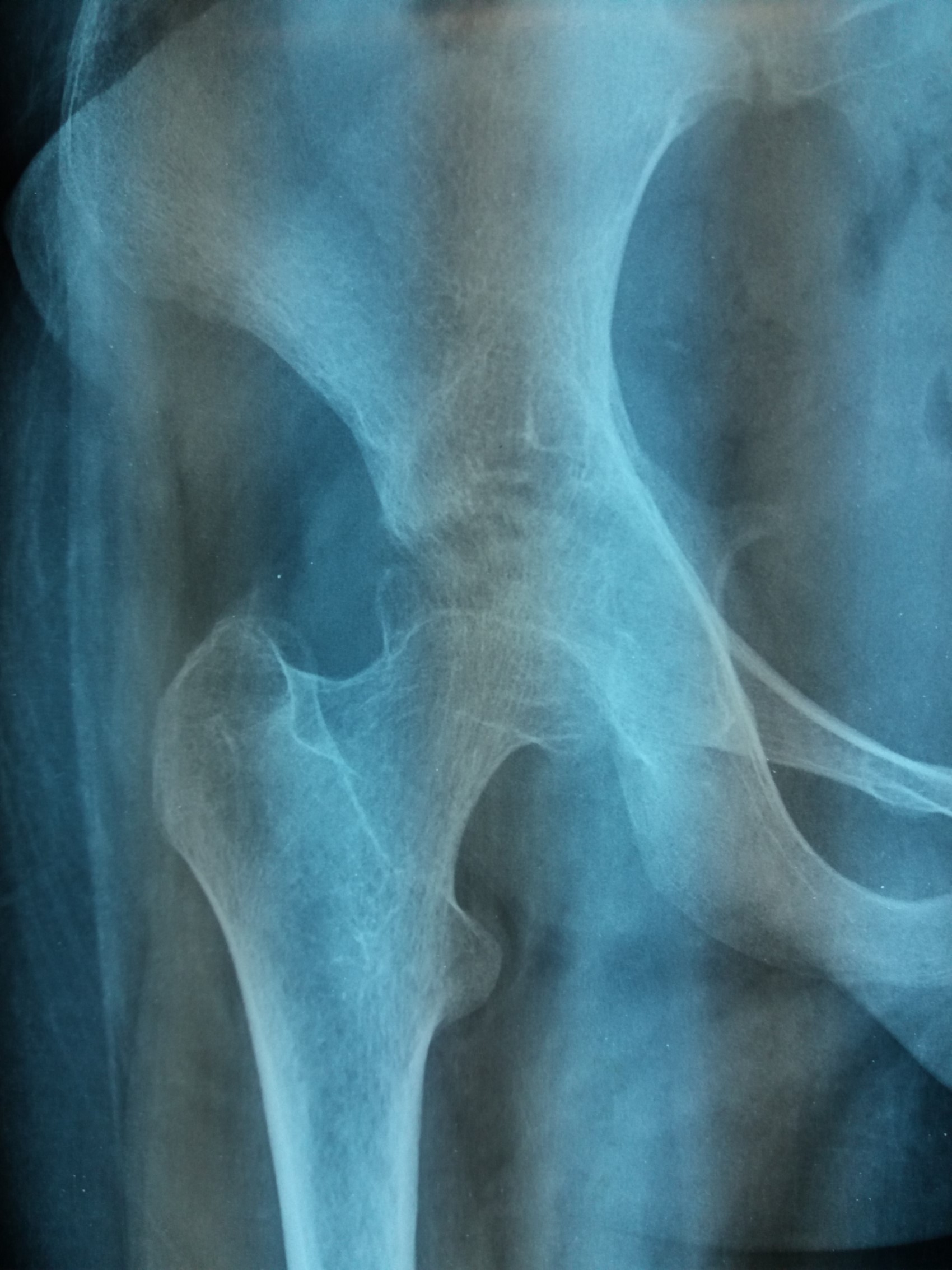 Pathology Outlines - Tuberculous arthritis