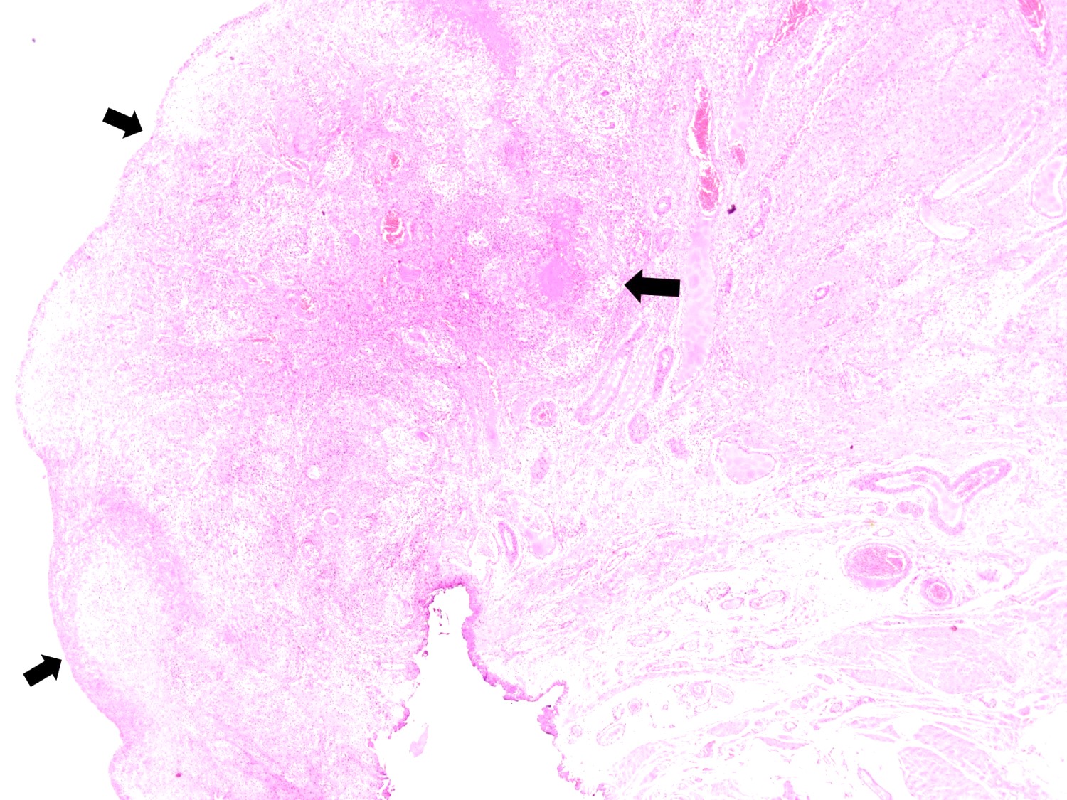 Pathology Outlines - Tuberculous arthritis