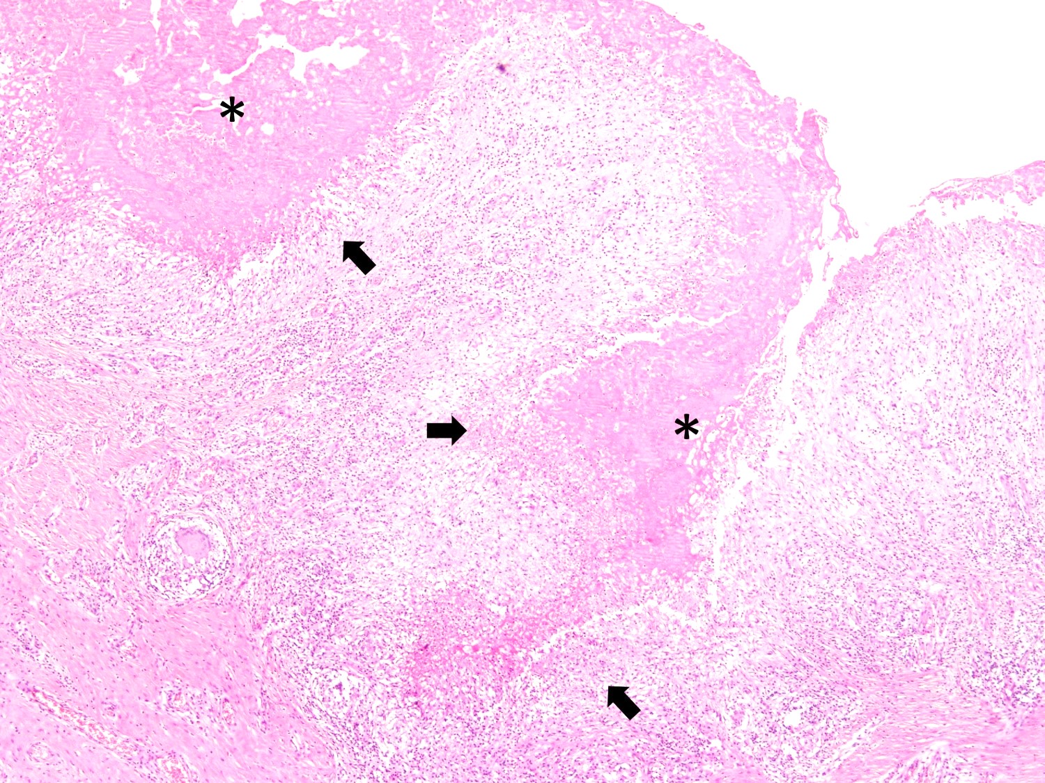Pathology Outlines - Tuberculous arthritis