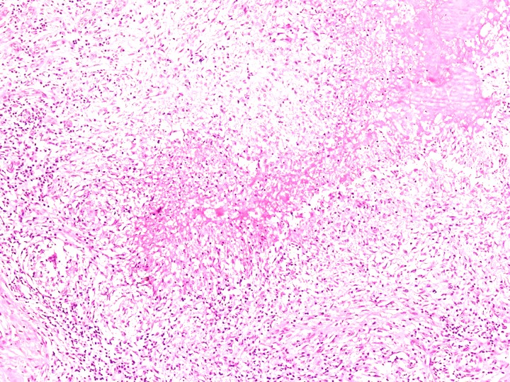 Pathology Outlines - Tuberculous arthritis