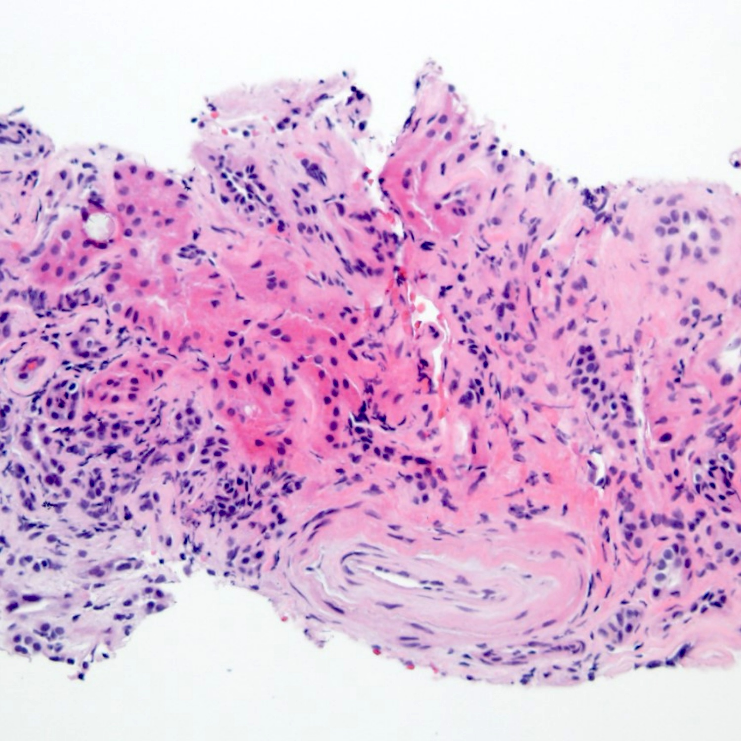 Pathology Outlines - Hematopoietic stem cell transplantation associated ...