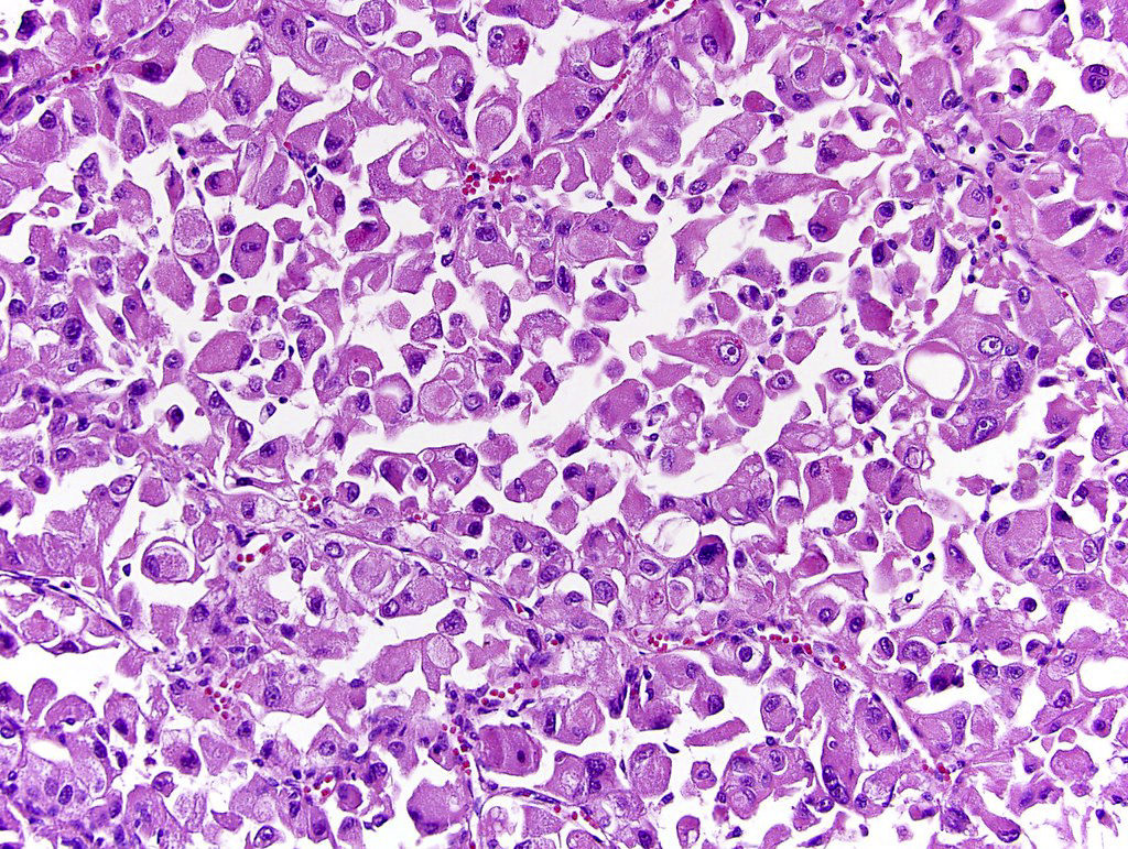 Pathology Outlines - Rhabdoid