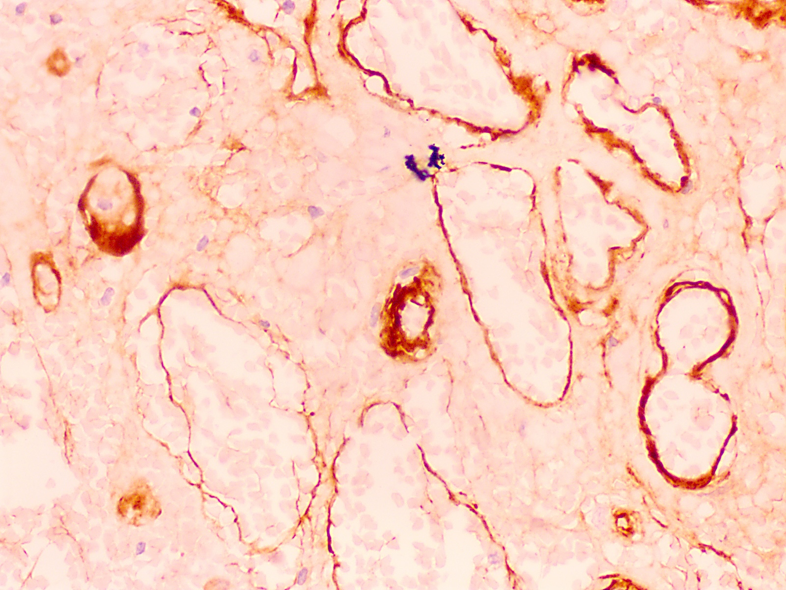 Pathology Outlines - Hyperacute rejection