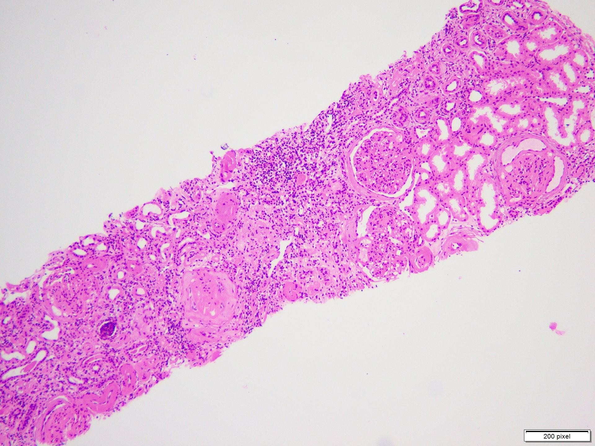 Pathology Outlines - Idiopathic nodular glomerulosclerosis