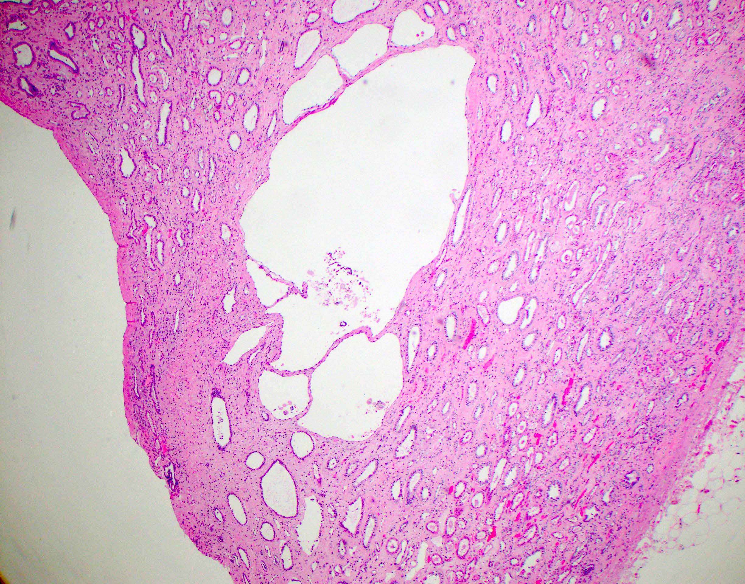 Polycystic Kidney Disease Histology