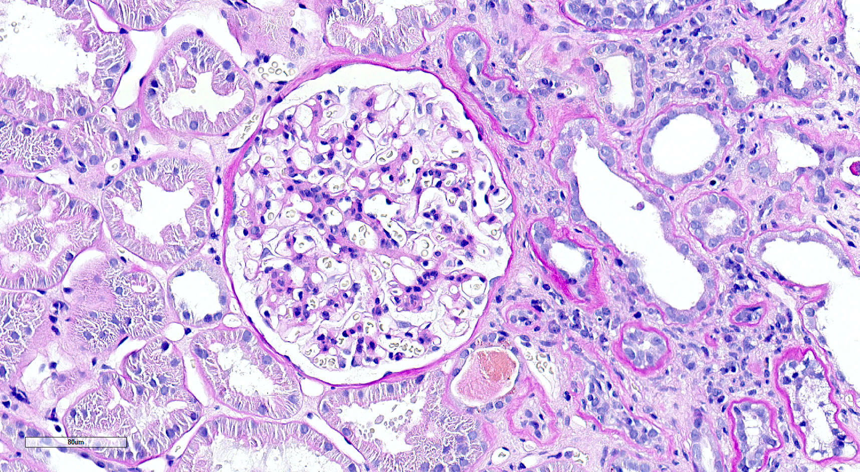 Pathology Outlines - Renal disease-general