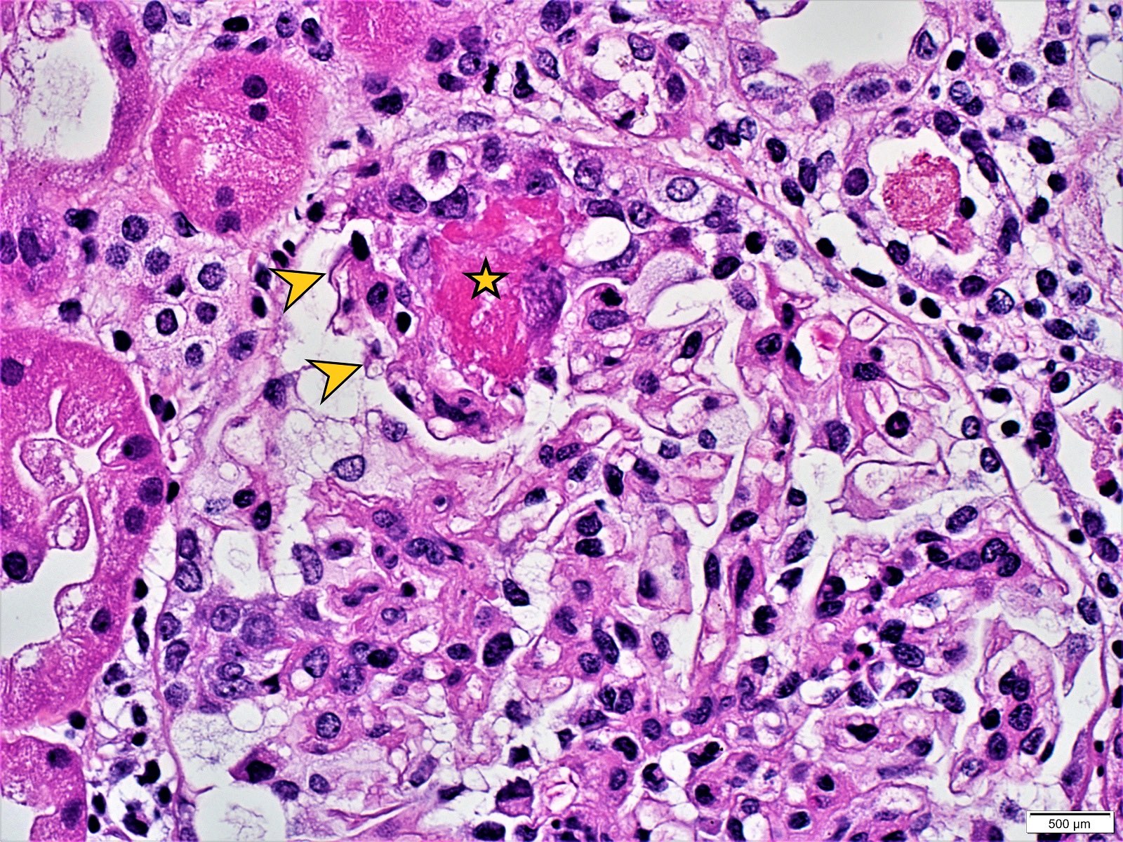 Pathology Outlines - Crescentic glomerulonephritis overview