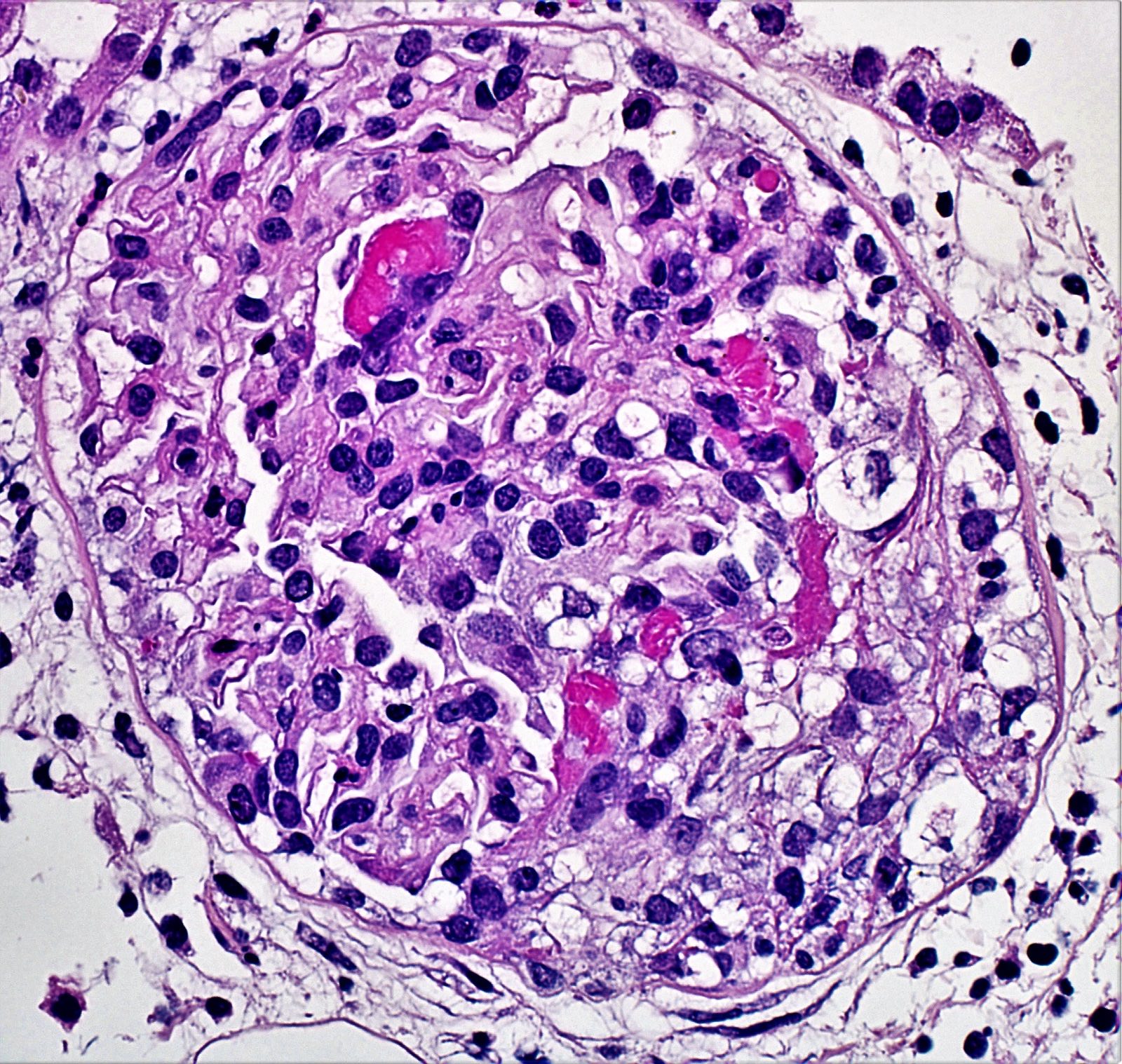 Pathology Outlines - Crescentic glomerulonephritis overview