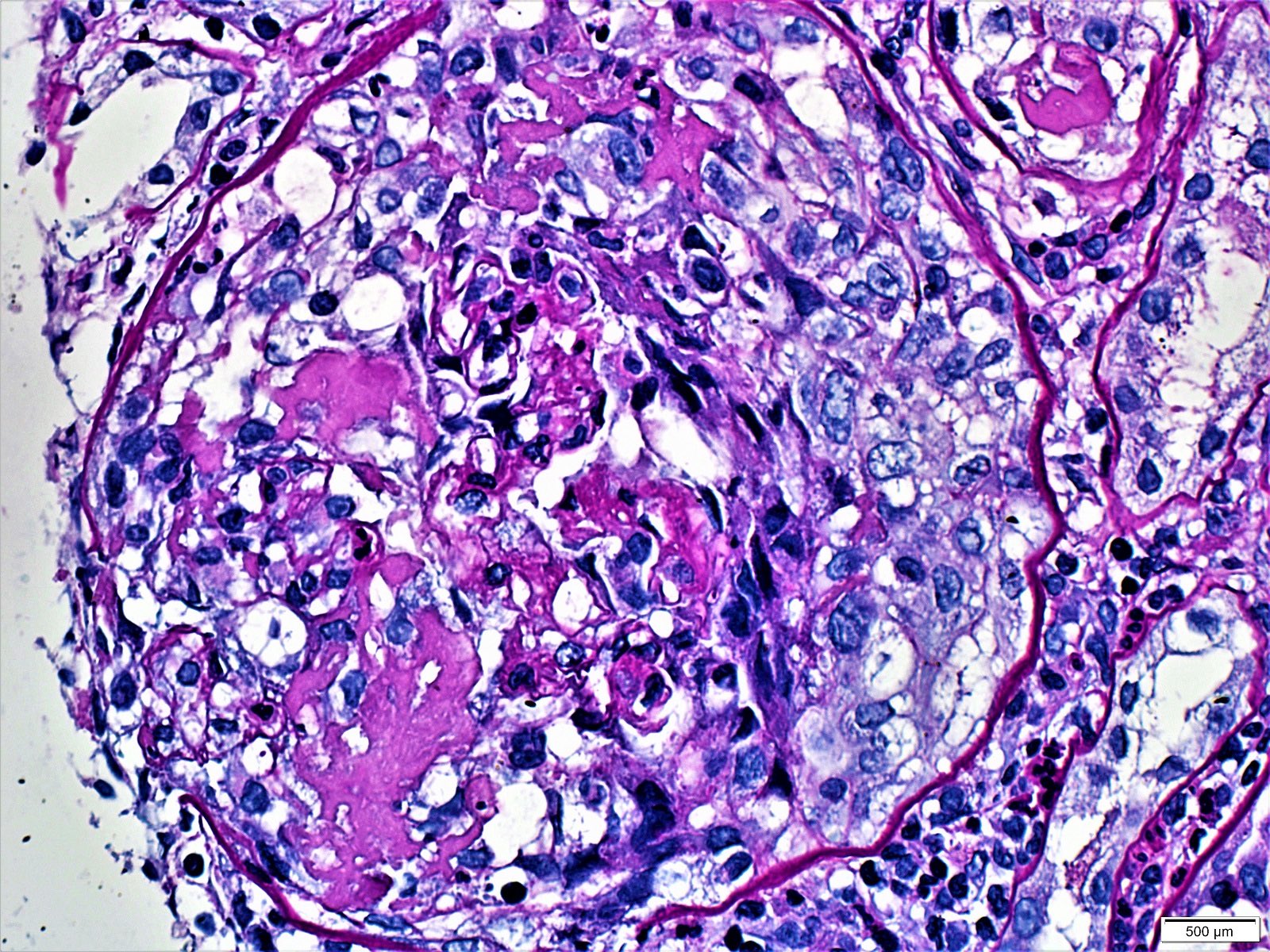Pathology Outlines - Crescentic glomerulonephritis overview