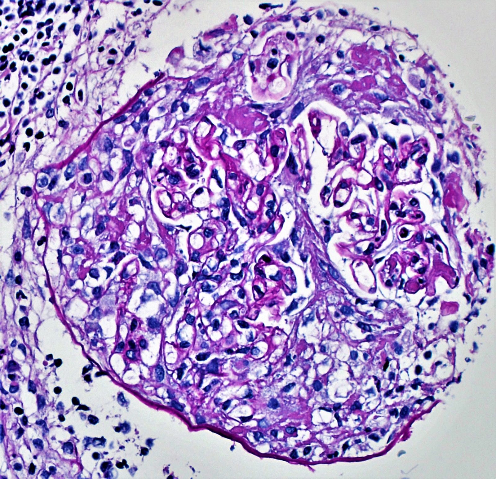 Pathology Outlines - Crescentic glomerulonephritis overview