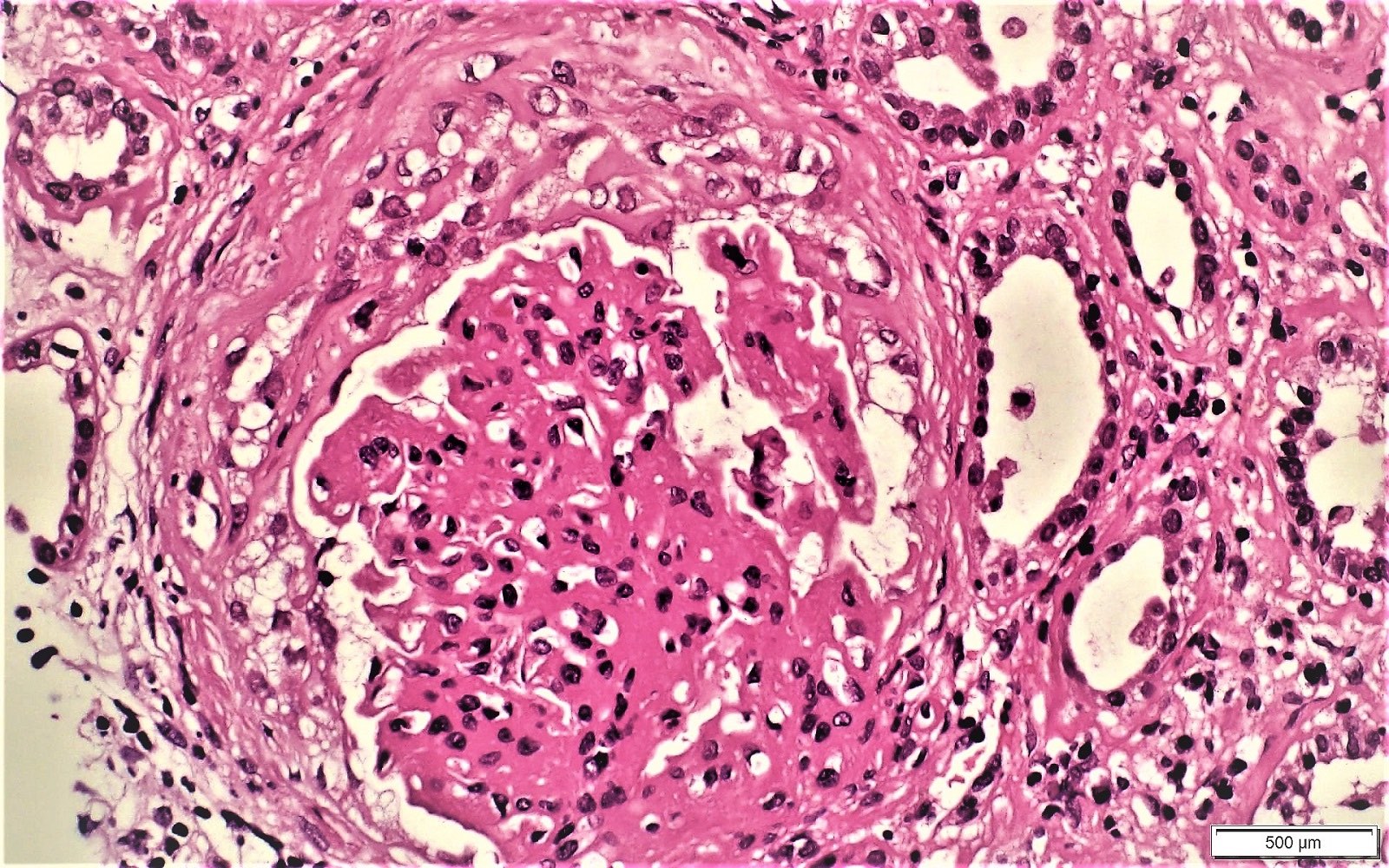 Pathology Outlines - Crescentic glomerulonephritis overview