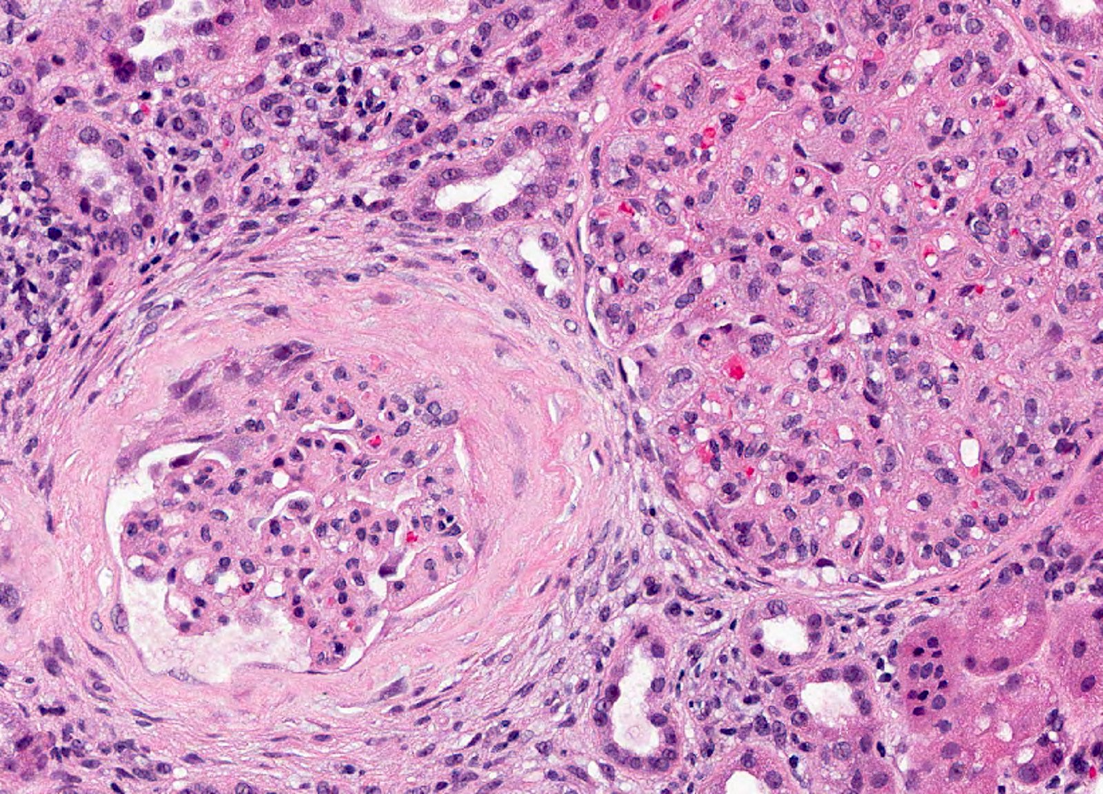 Pathology Outlines - Crescentic glomerulonephritis overview